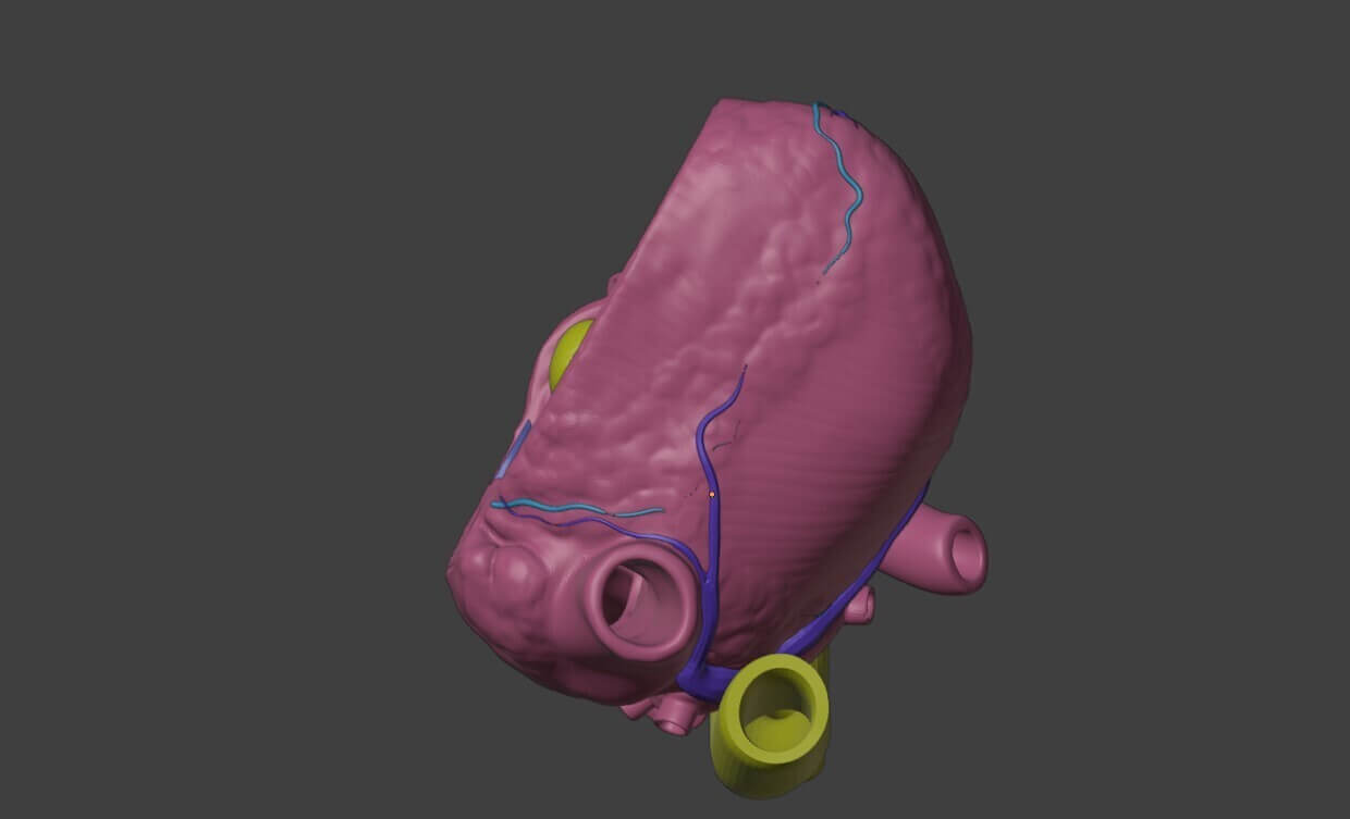 3D Model of Heart With Double Outlet Right Ventricle by azekapeka