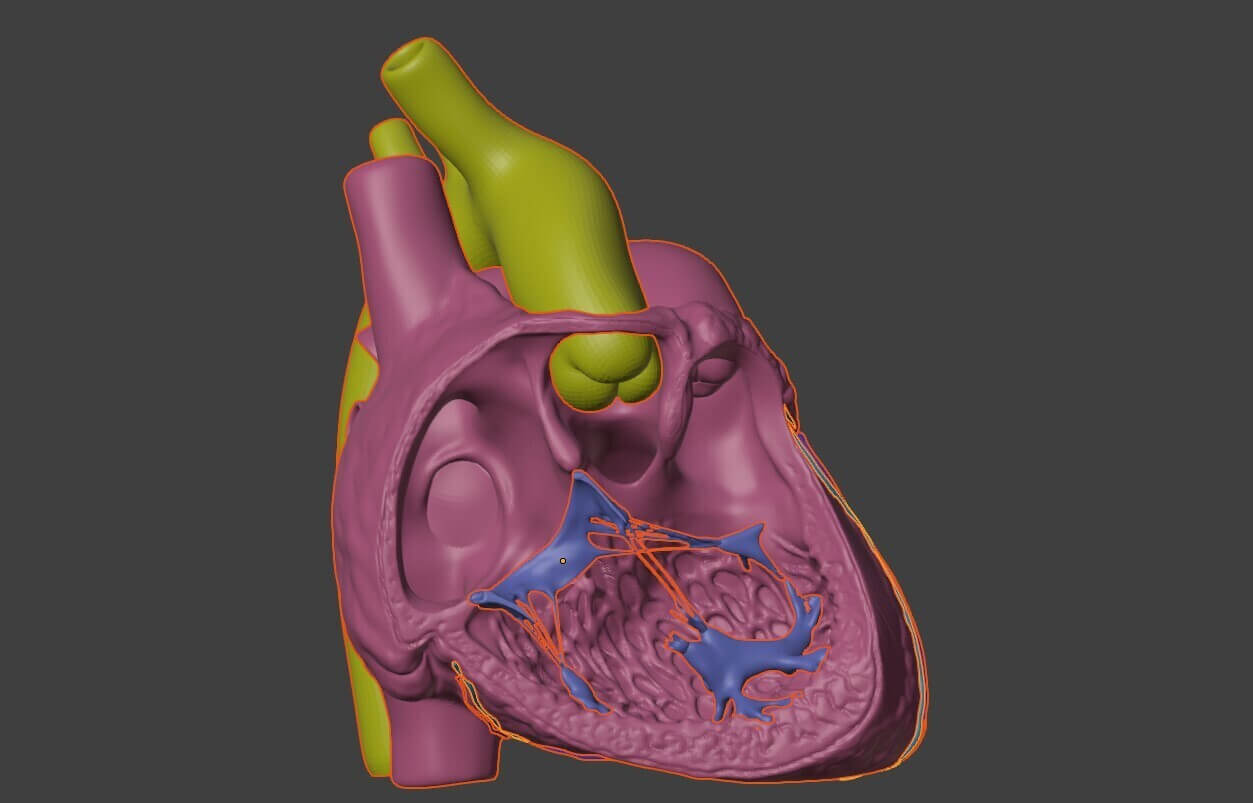 3D Model of Heart With Double Outlet Right Ventricle by azekapeka