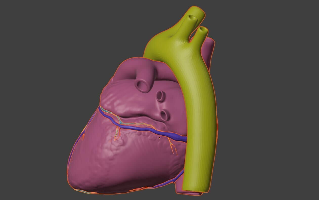 3D Model of Heart With Double Outlet Right Ventricle by azekapeka