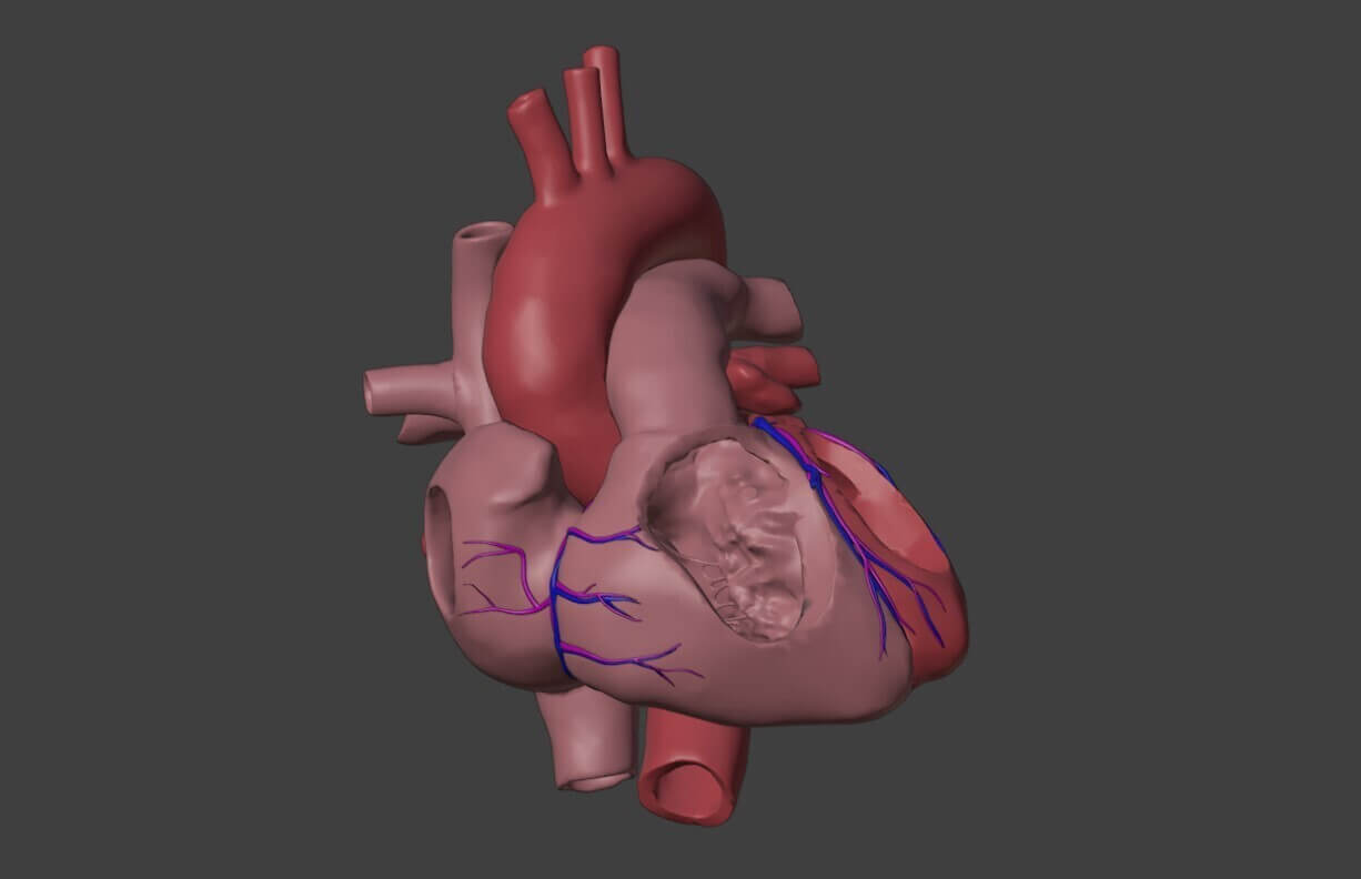 3D Model of Heart With Partial Anomalous Pulmonary Venous by azekapeka