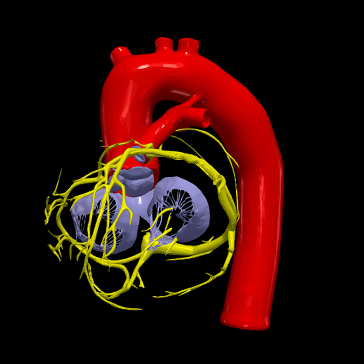 3D Model of Heart With Tetralogy of Fallot (Tof) by azekapeka