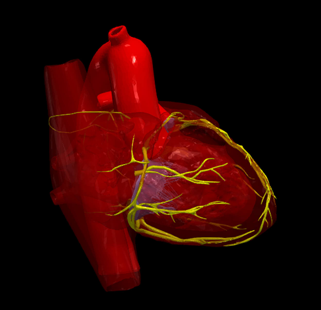 3D Model of Heart With Tetralogy of Fallot (Tof) by azekapeka