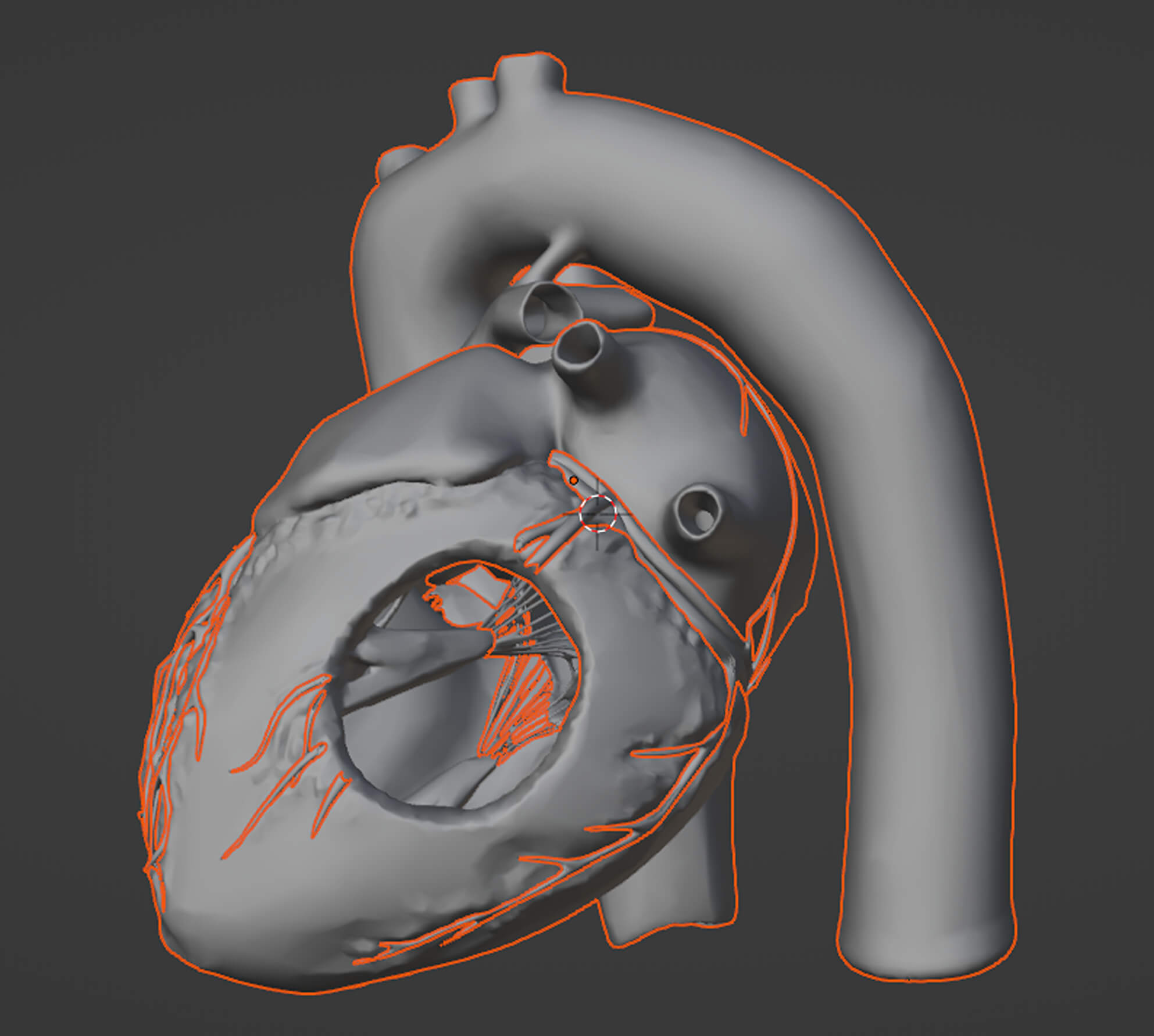 3D Model of Heart With Tetralogy of Fallot (Tof) by azekapeka
