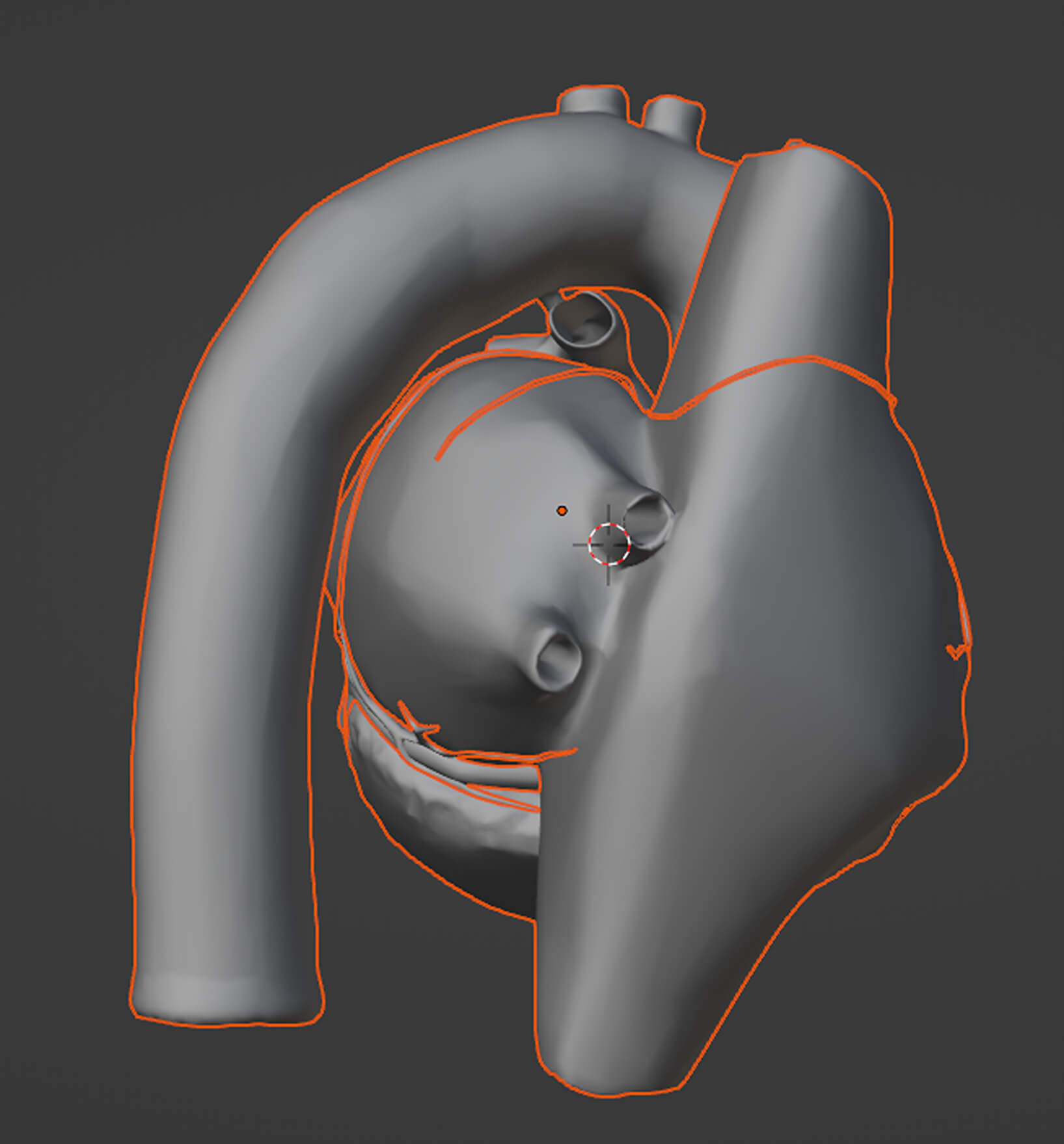 3D Model of Heart With Tetralogy of Fallot (Tof) by azekapeka
