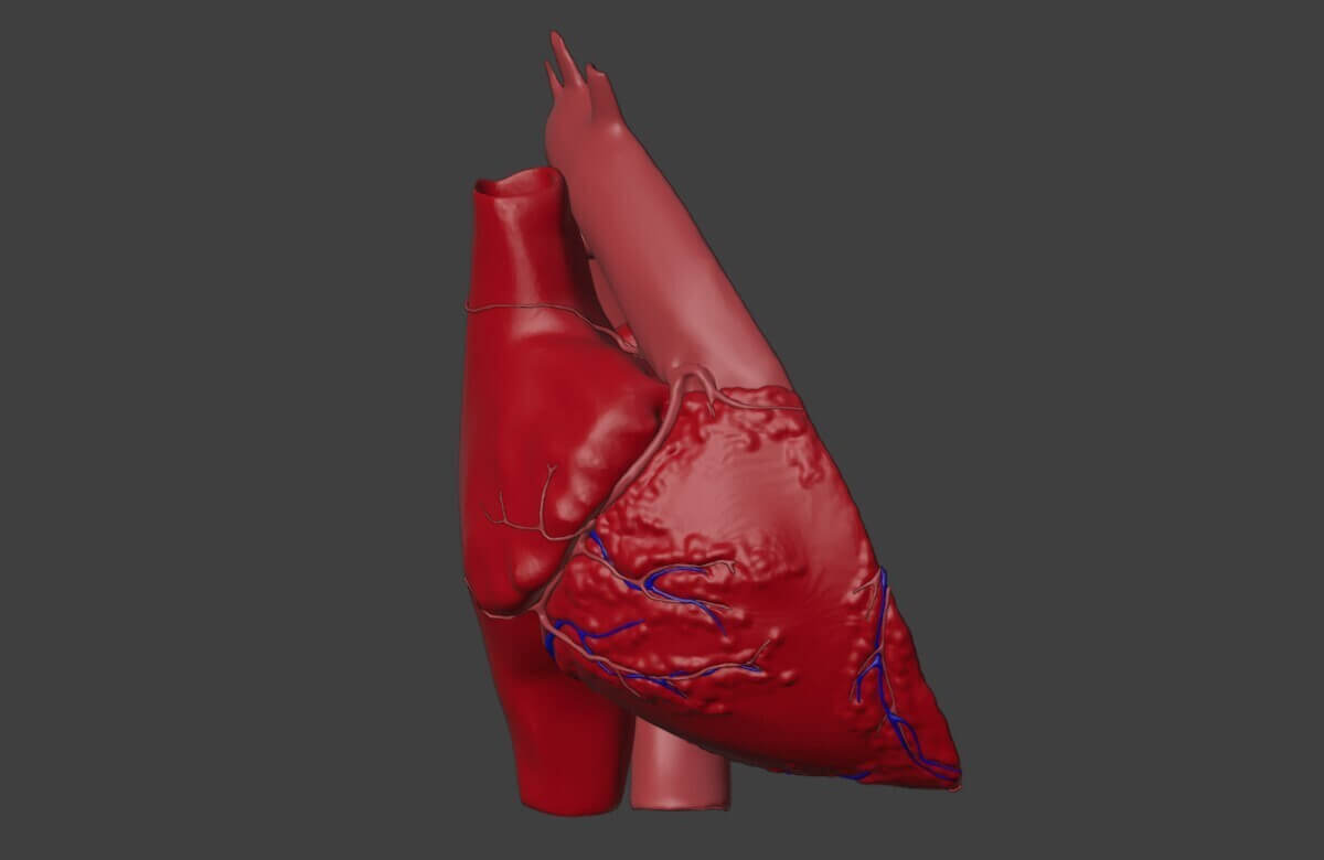 3D Model of Heart With Transposition of The Great Arteries by azekapeka