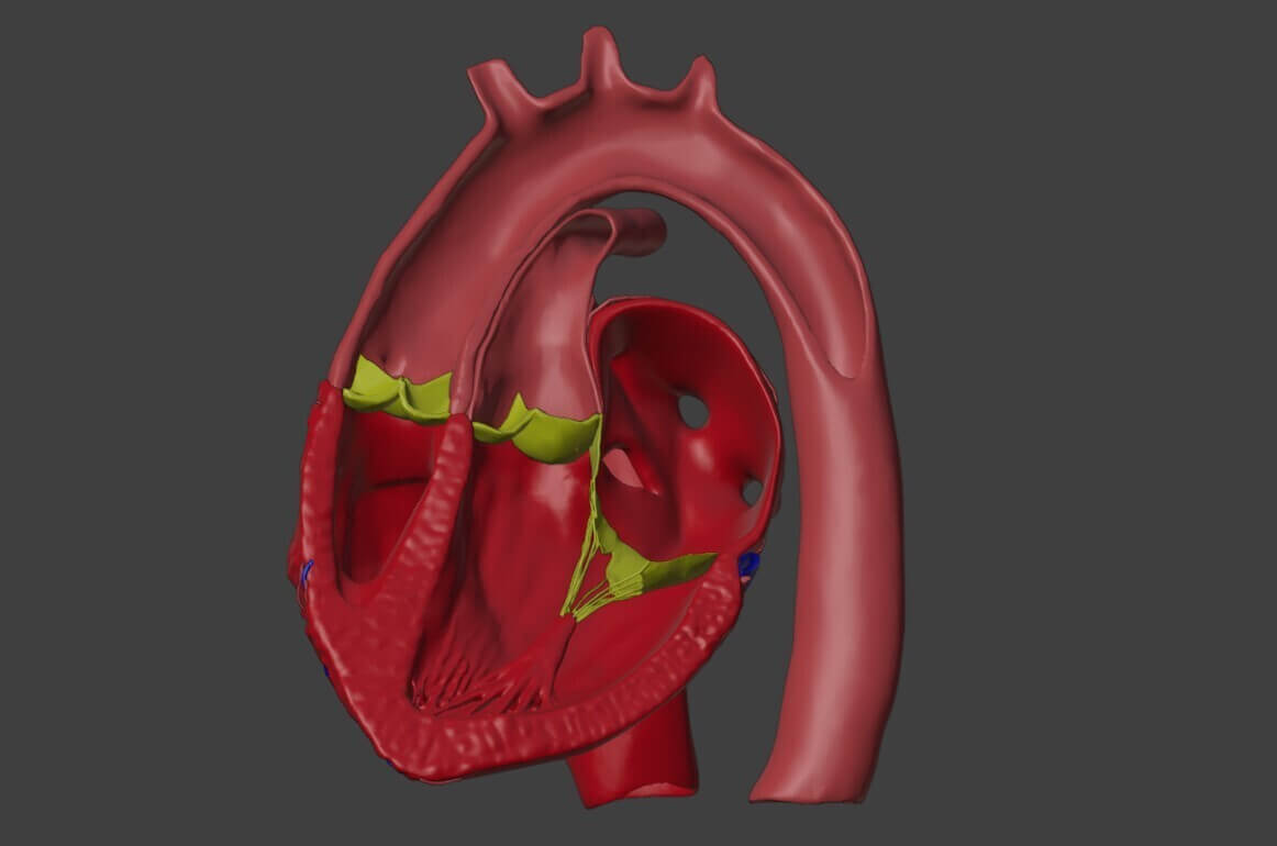 3D Model of Heart With Transposition of The Great Arteries by azekapeka