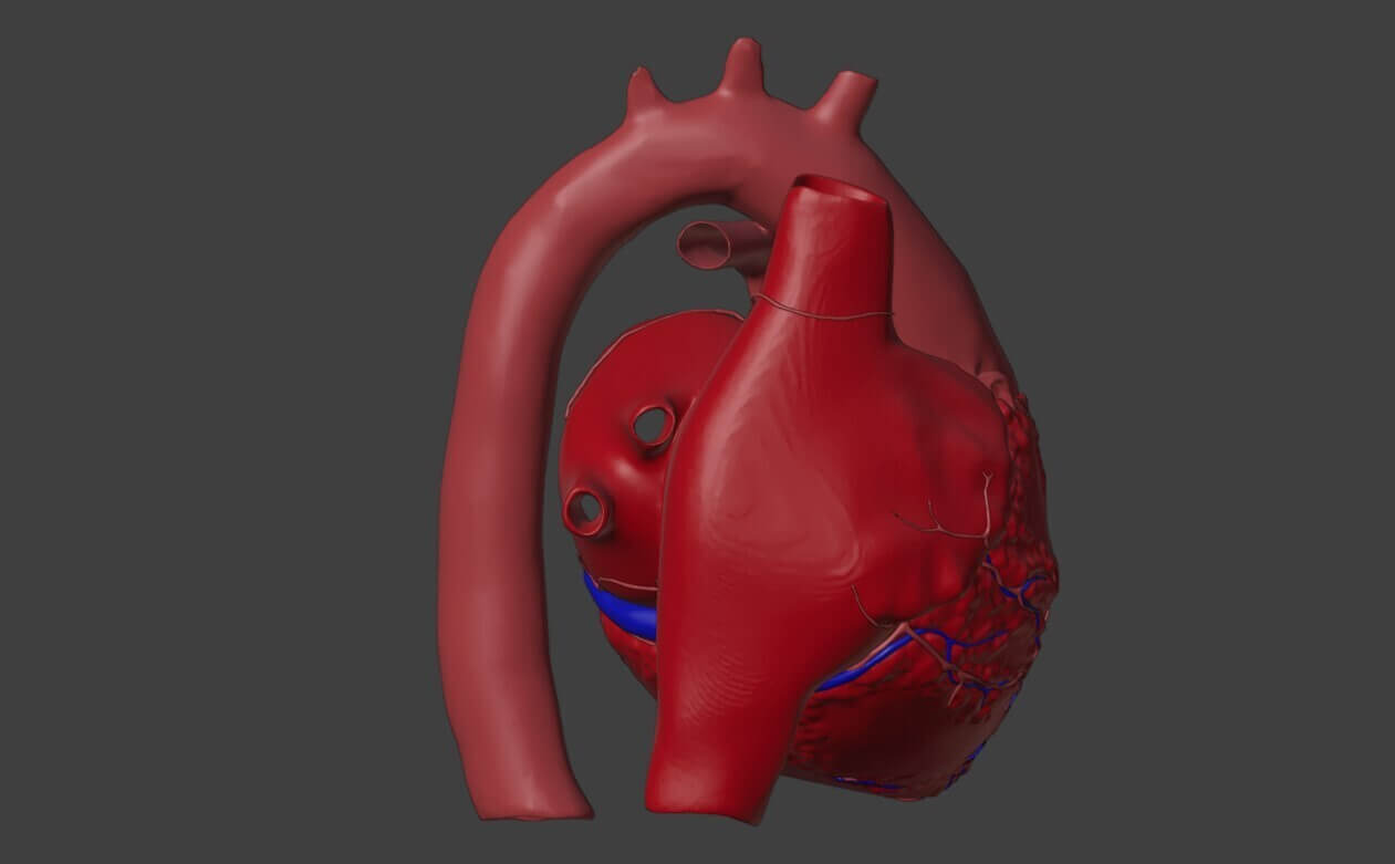 3D Model of Heart With Transposition of The Great Arteries by azekapeka
