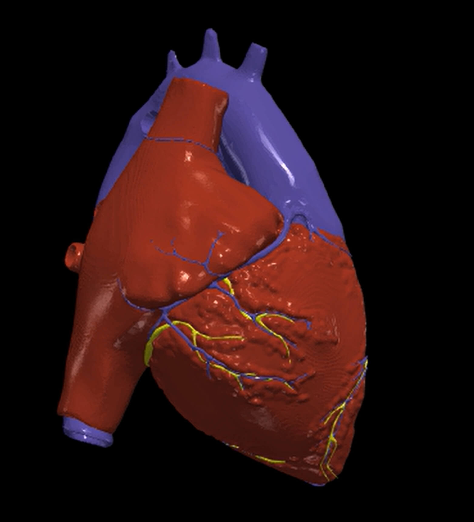 3D Model of Heart With Transposition of The Great Arteries by azekapeka