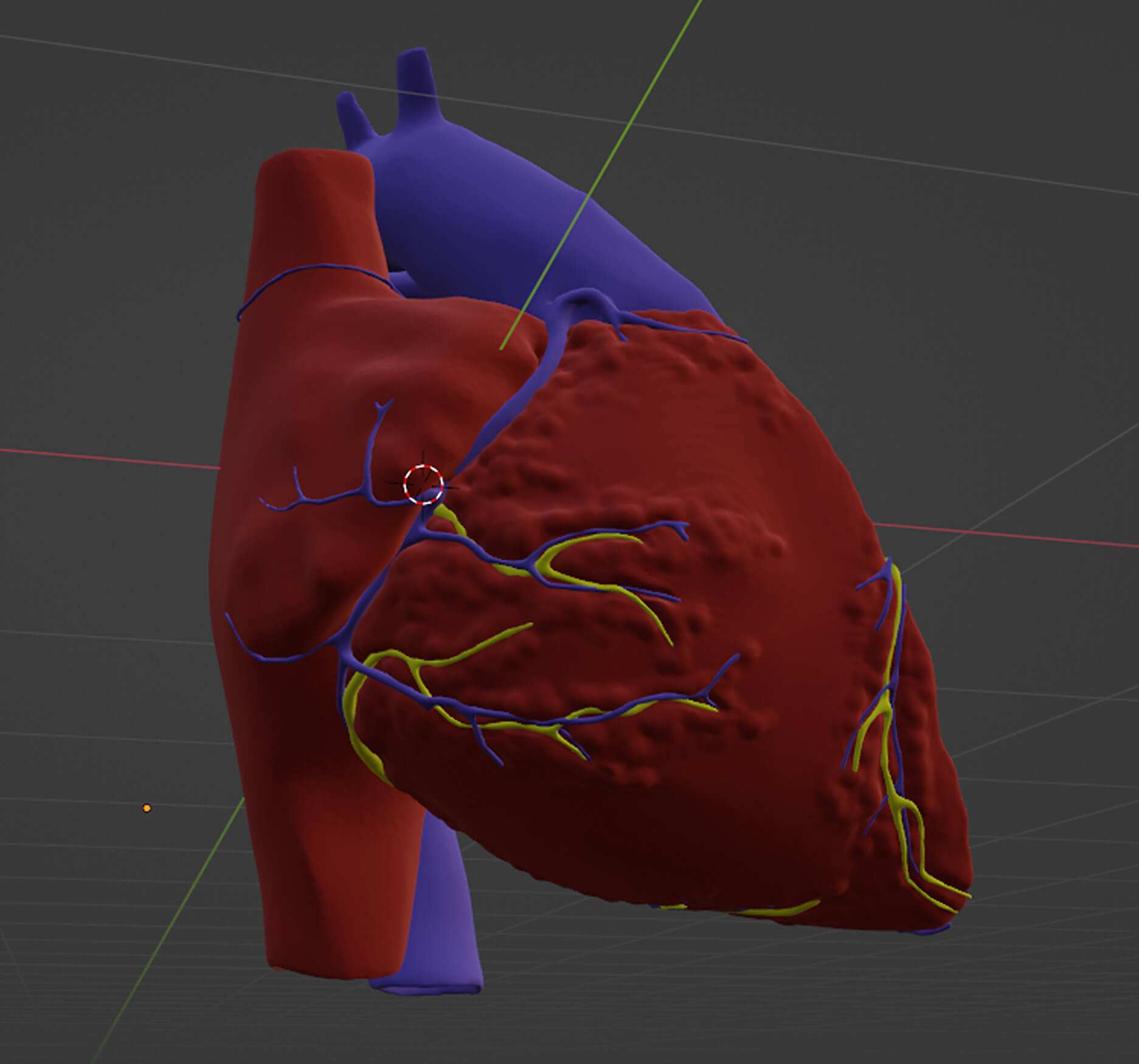 3D Model of Heart With Transposition of The Great Arteries by azekapeka
