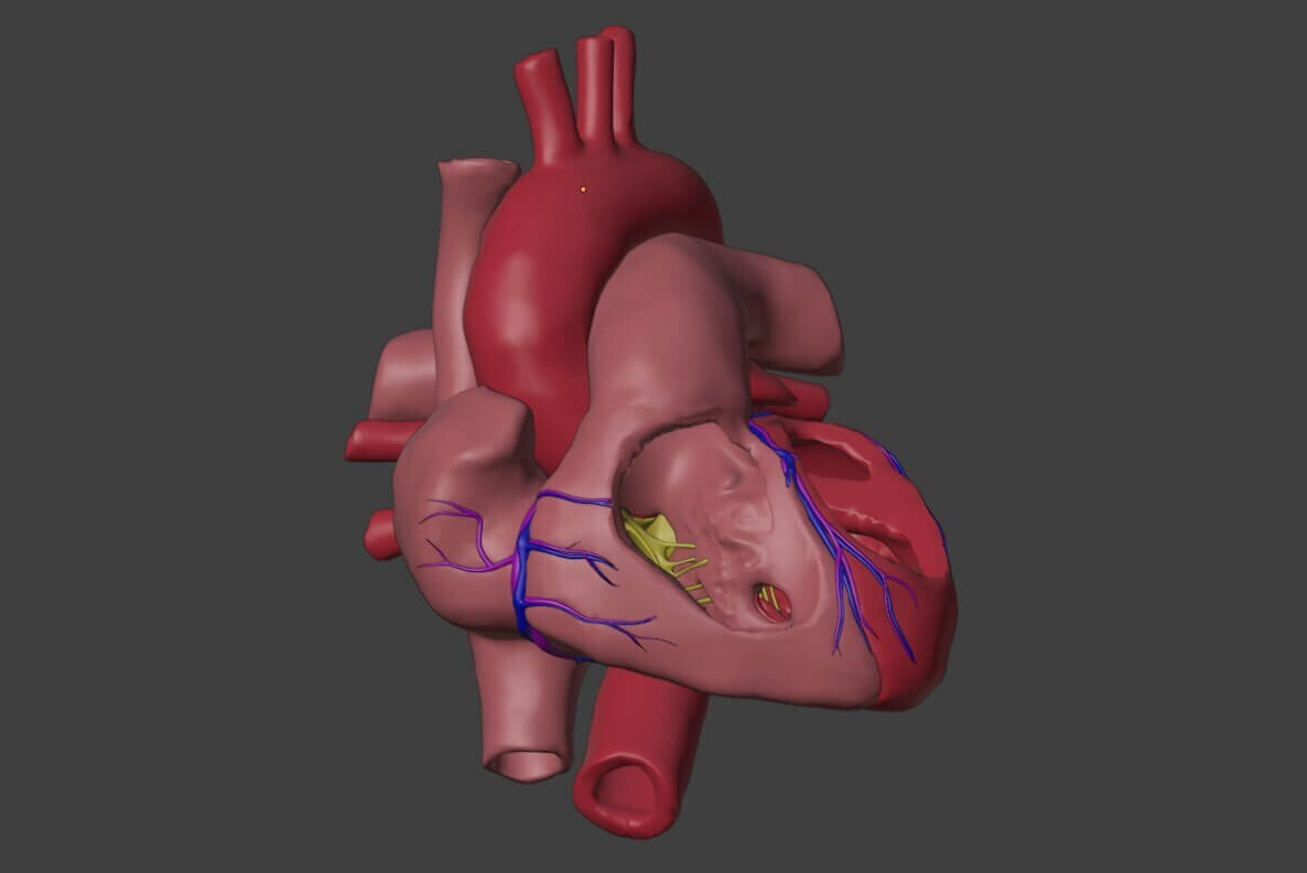 3D Model of Heart With Ventricular Septal Defect by azekapeka