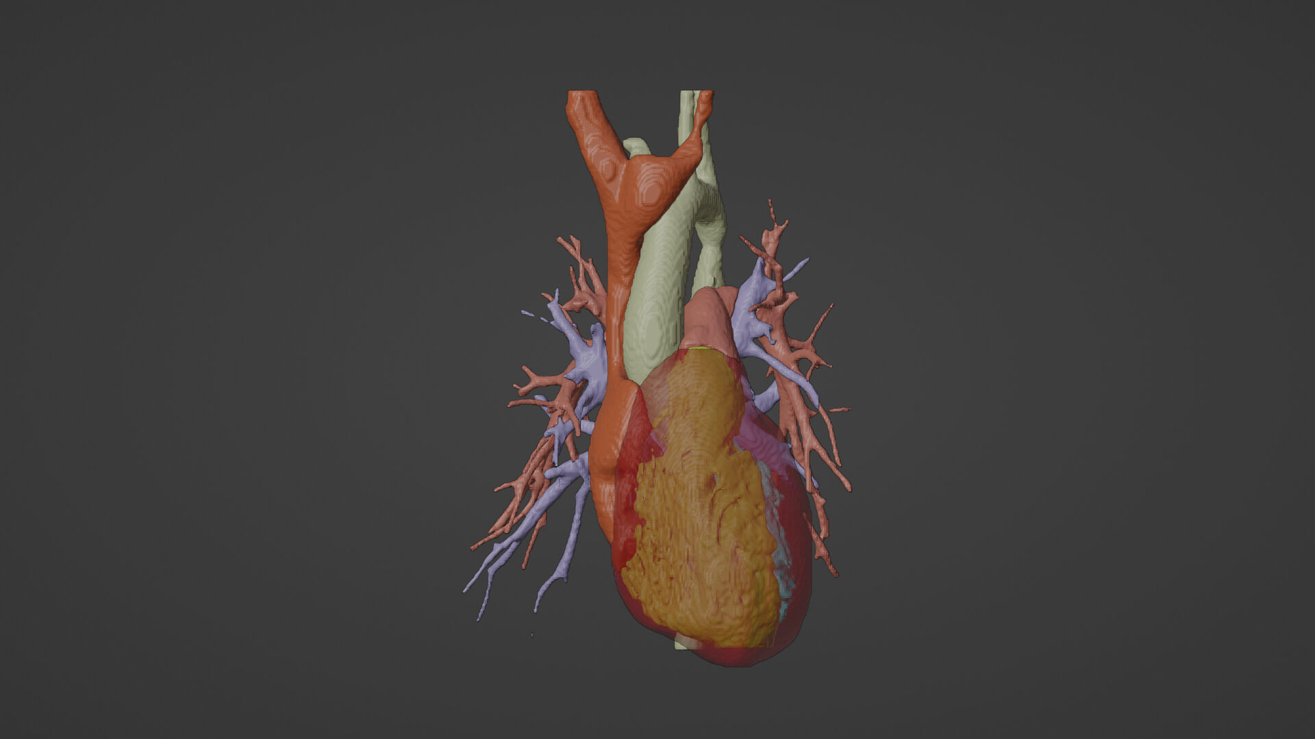 3D Model of Human Heart With Co-Arctation (CA) by azekapeka