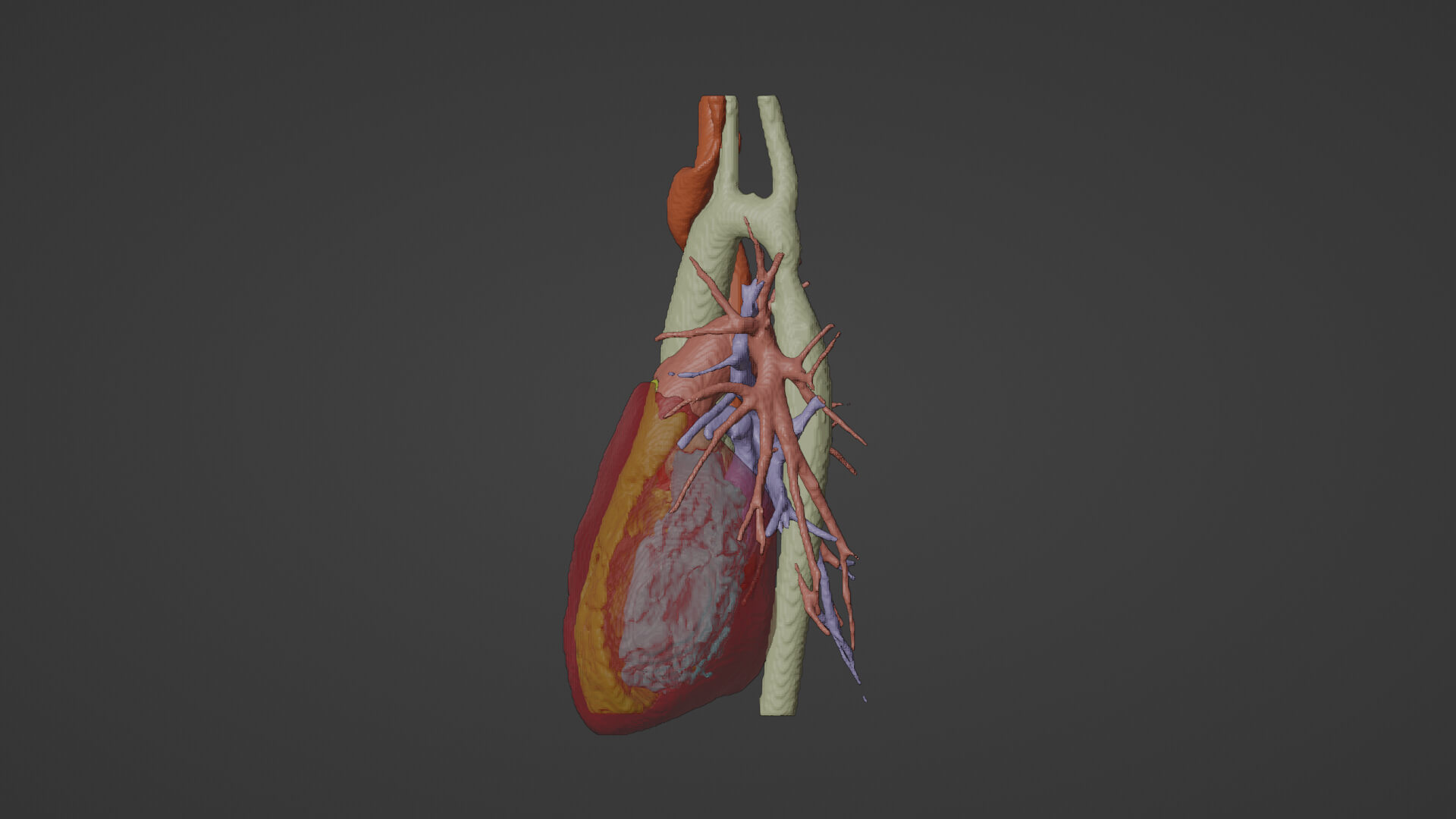 3D Model of Human Heart With Co-Arctation (CA) by azekapeka