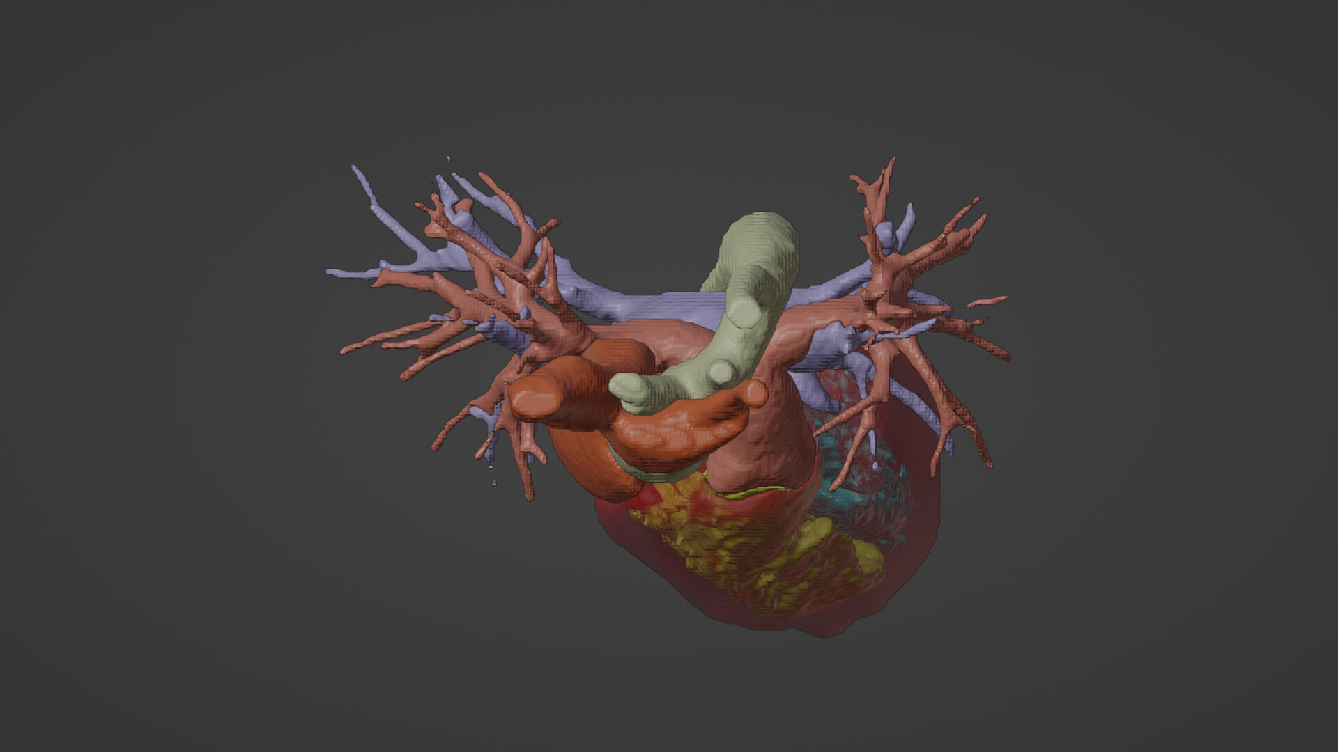 3D Model of Human Heart With Co-Arctation (CA) by azekapeka