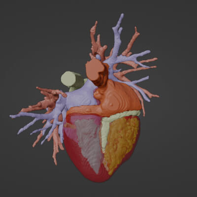 3D Model of Human Heart With Double Aortic Arch by azekapeka