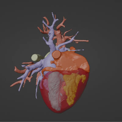 3D Model of Human Heart With Double Outlet Right Ventricle by azekapeka