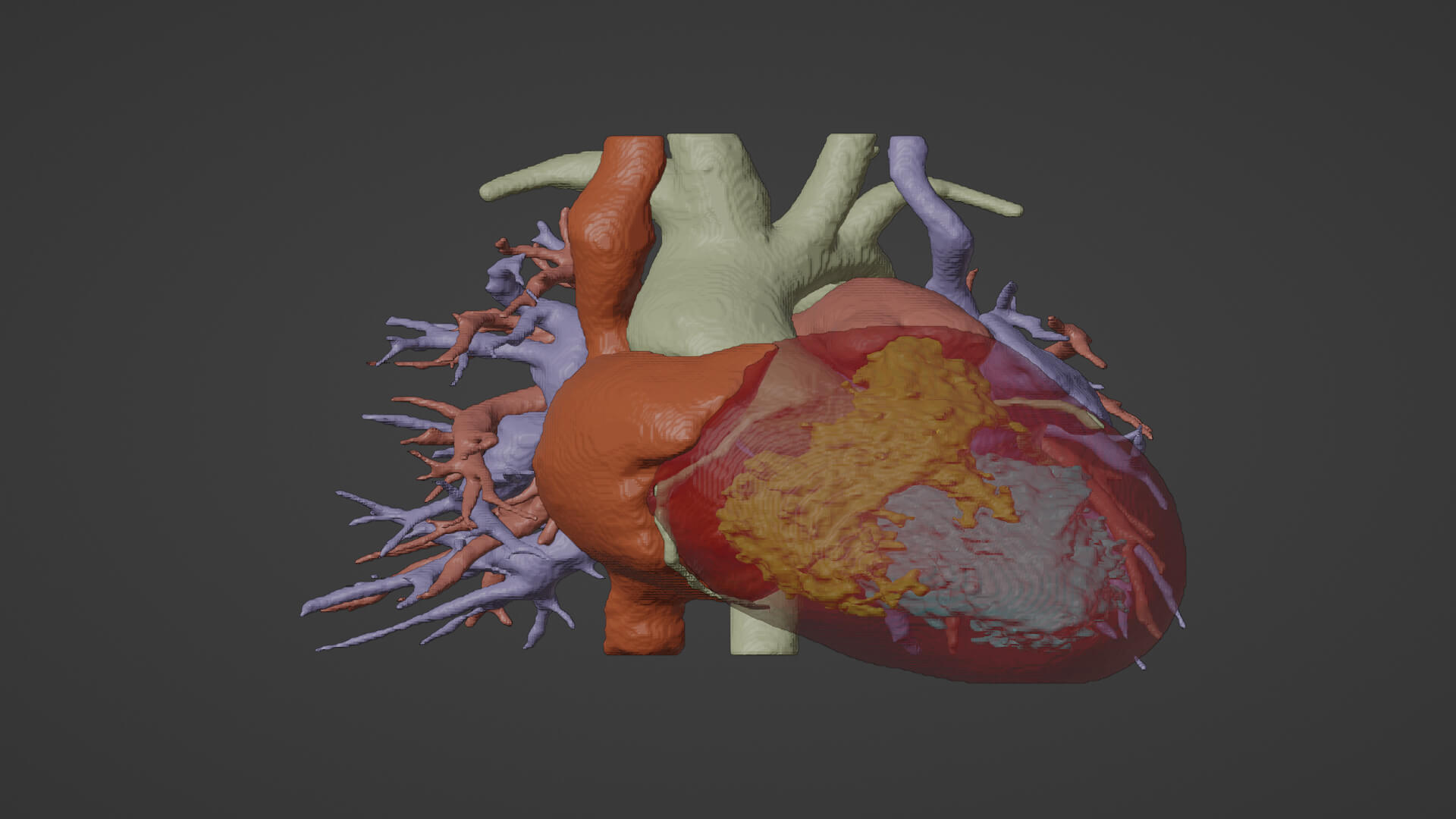3D Model of Human Heart With Double Superior Vena Cava -Dsvc by azekapeka