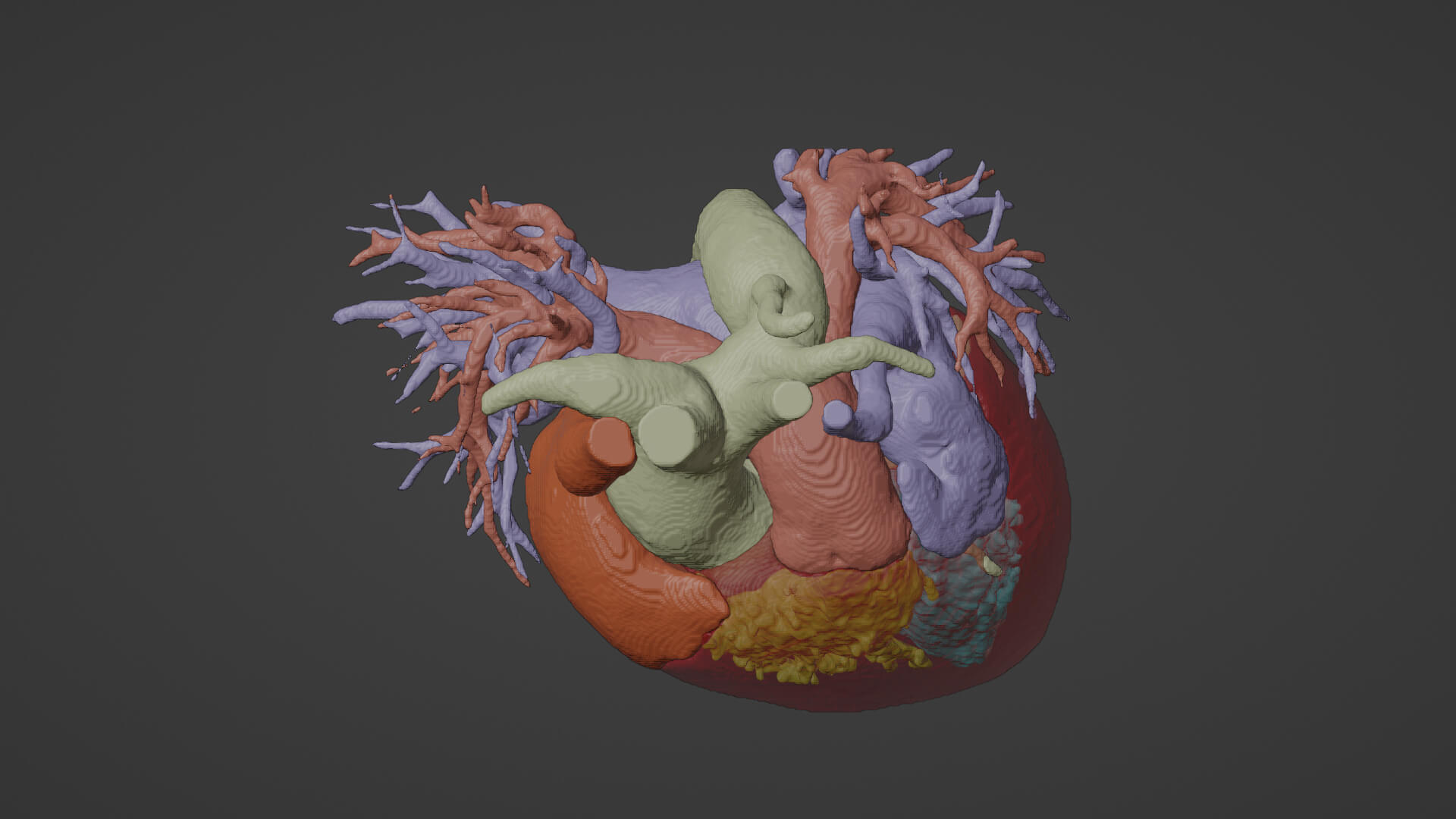 3D Model of Human Heart With Double Superior Vena Cava -Dsvc by azekapeka