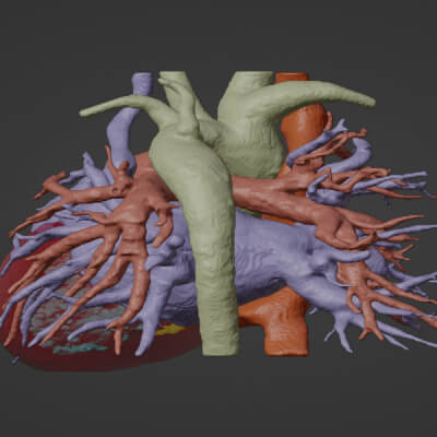 3D Model of Human Heart With Double Superior Vena Cava -Dsvc by azekapeka