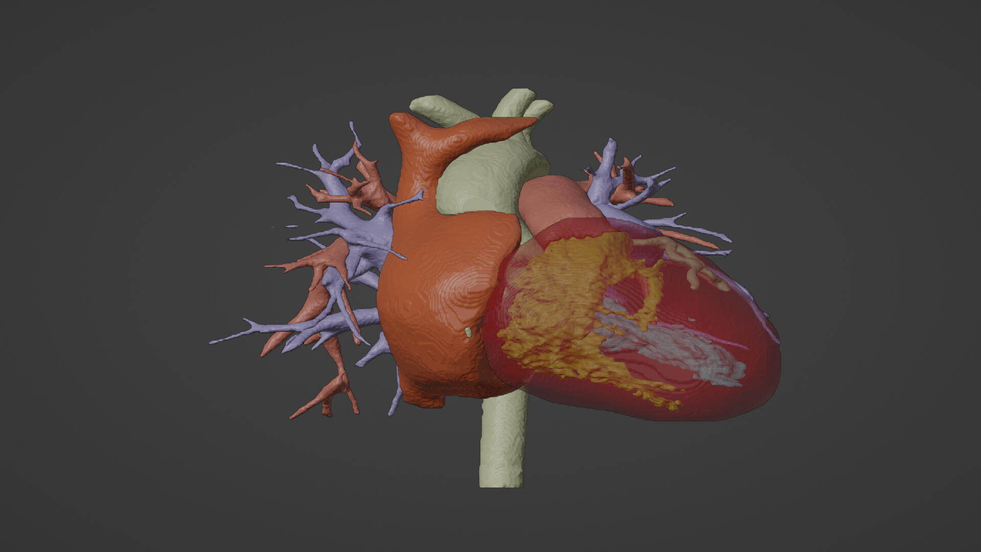 3D Model of Human Heart With Hypertrophic Cardiomyopathy by azekapeka
