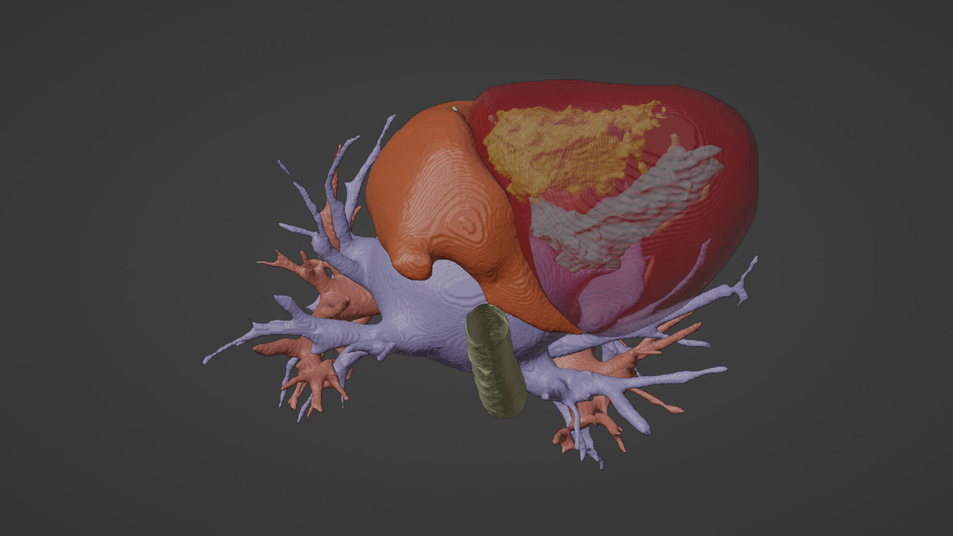 3D Model of Human Heart With Hypertrophic Cardiomyopathy by azekapeka