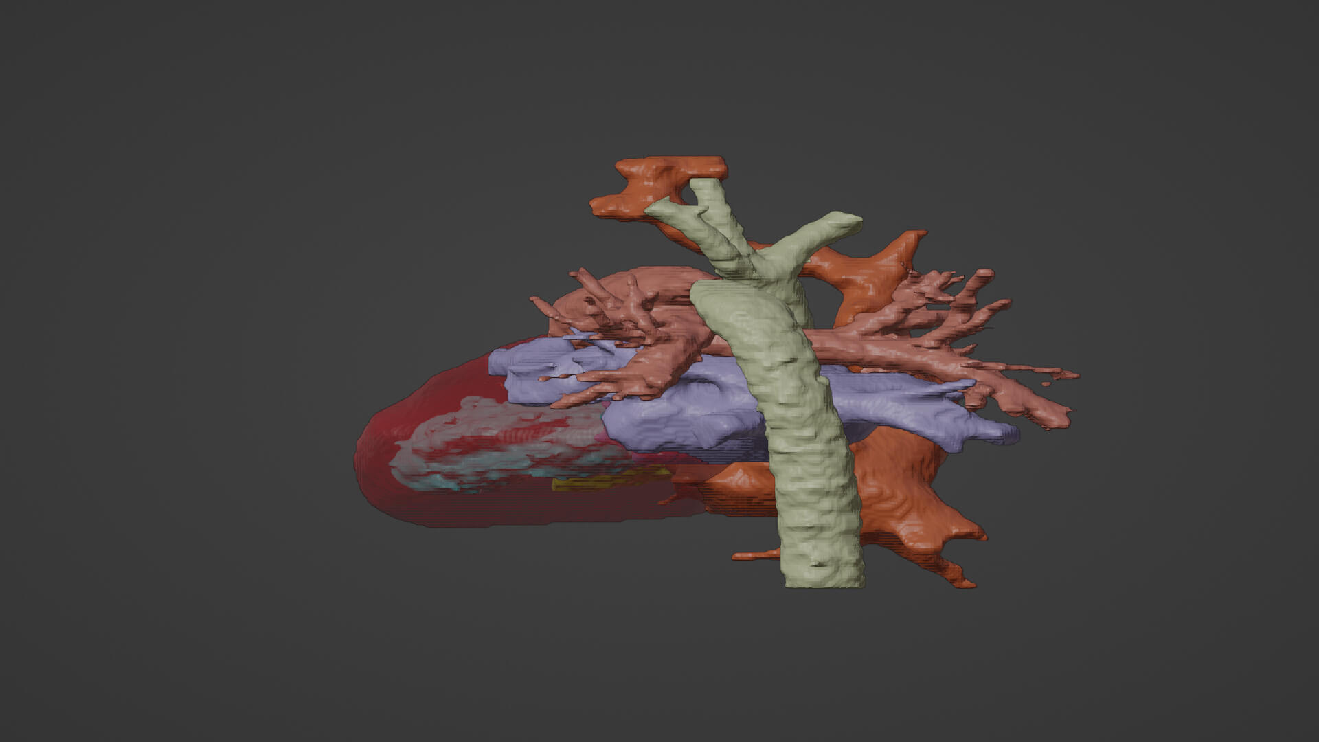 3D Model of Human Heart With Interrupted Aortic Arch (Iaa) by azekapeka