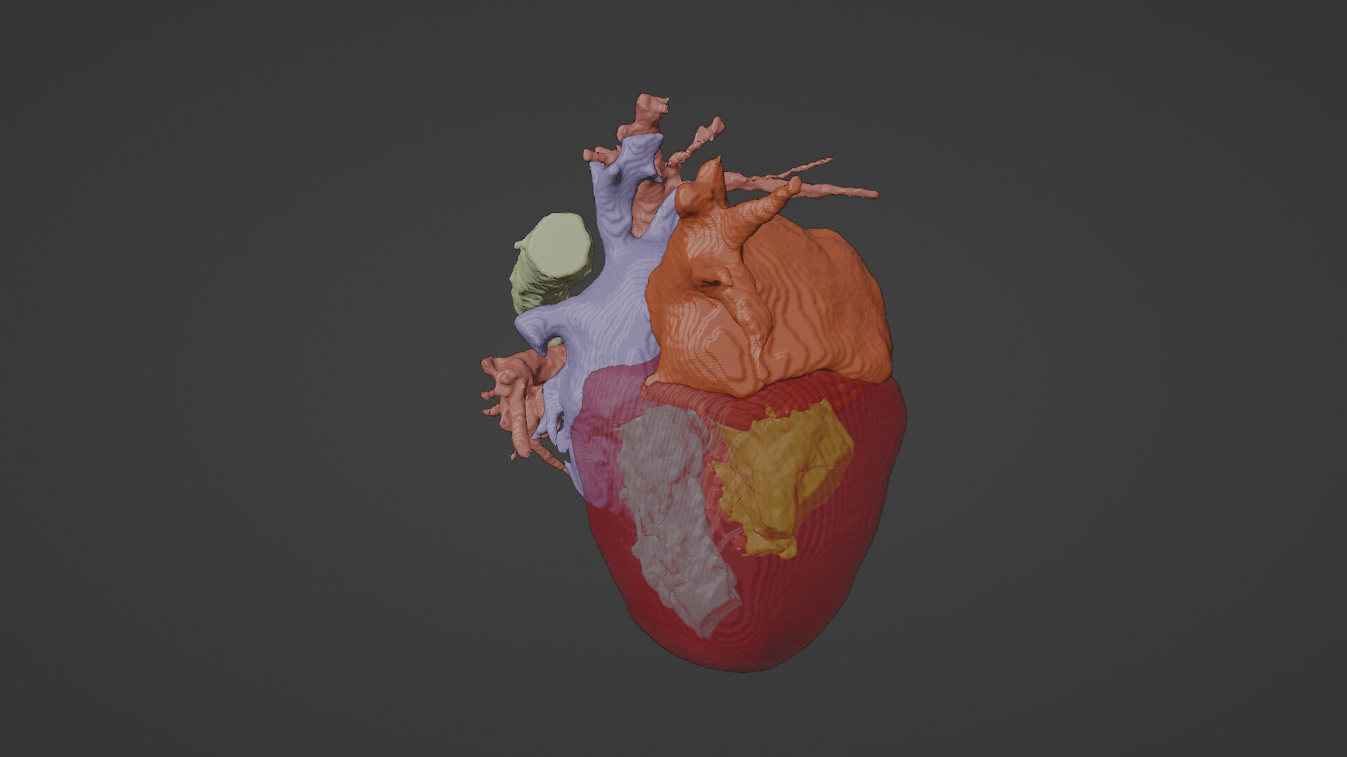3D Model of Human Heart With Interrupted Aortic Arch (Iaa) by azekapeka