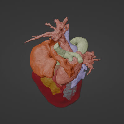 3D Model of Human Heart With Interrupted Aortic Arch (Iaa) by azekapeka
