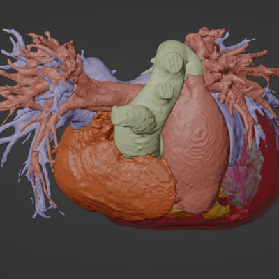 3D Model of Human Heart With Patent Ductus Arteriosus (Pda) by azekapeka