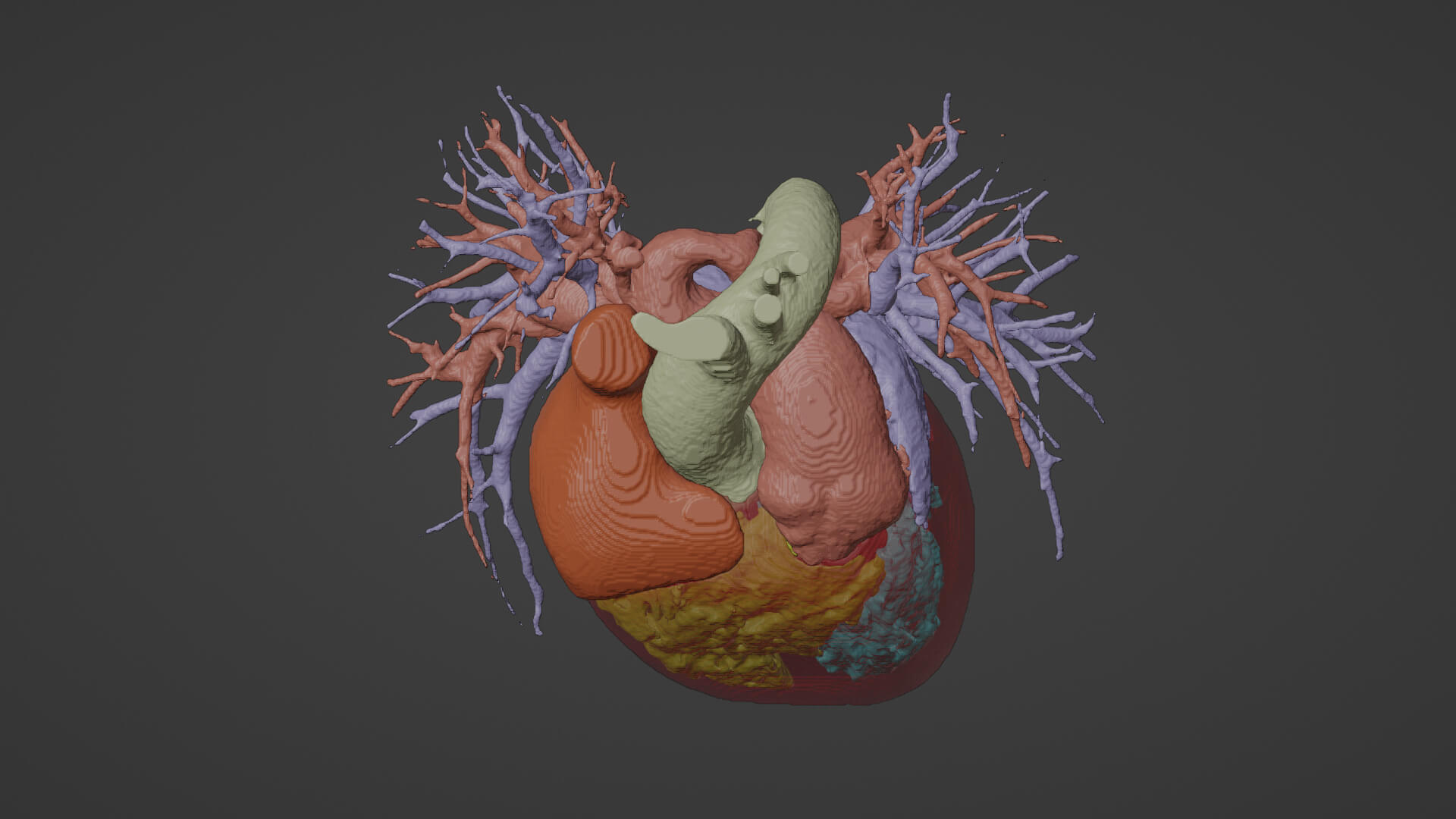 3D Model of Human Heart With Pulmonary Artery Sling (Pas) by azekapeka