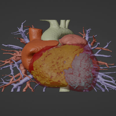 3D Model of Human Heart With Pulmonary Artery Sling (Pas) by azekapeka