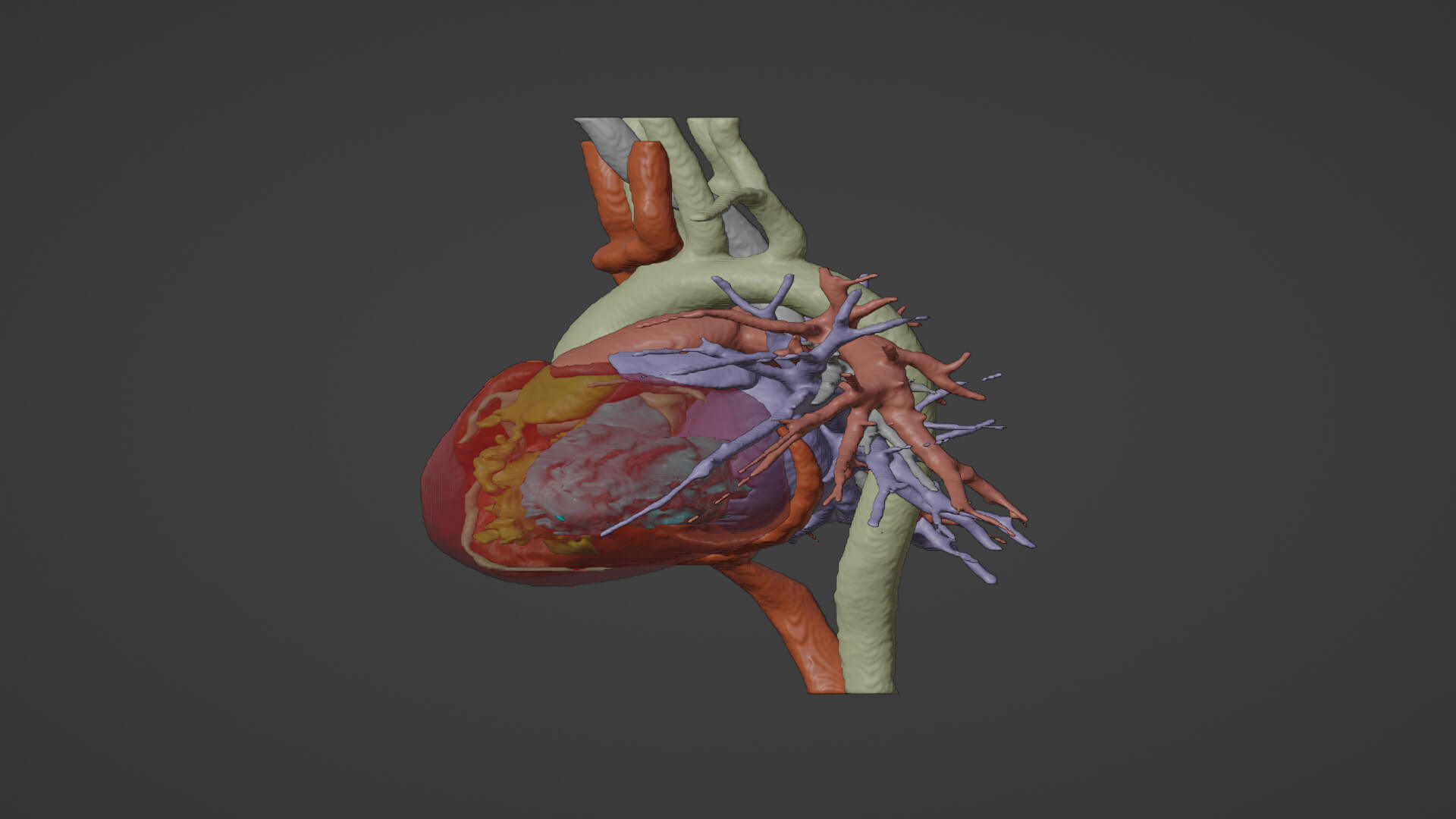 3D Model of Human Heart With Tetrology of Fallot (Tof) by azekapeka