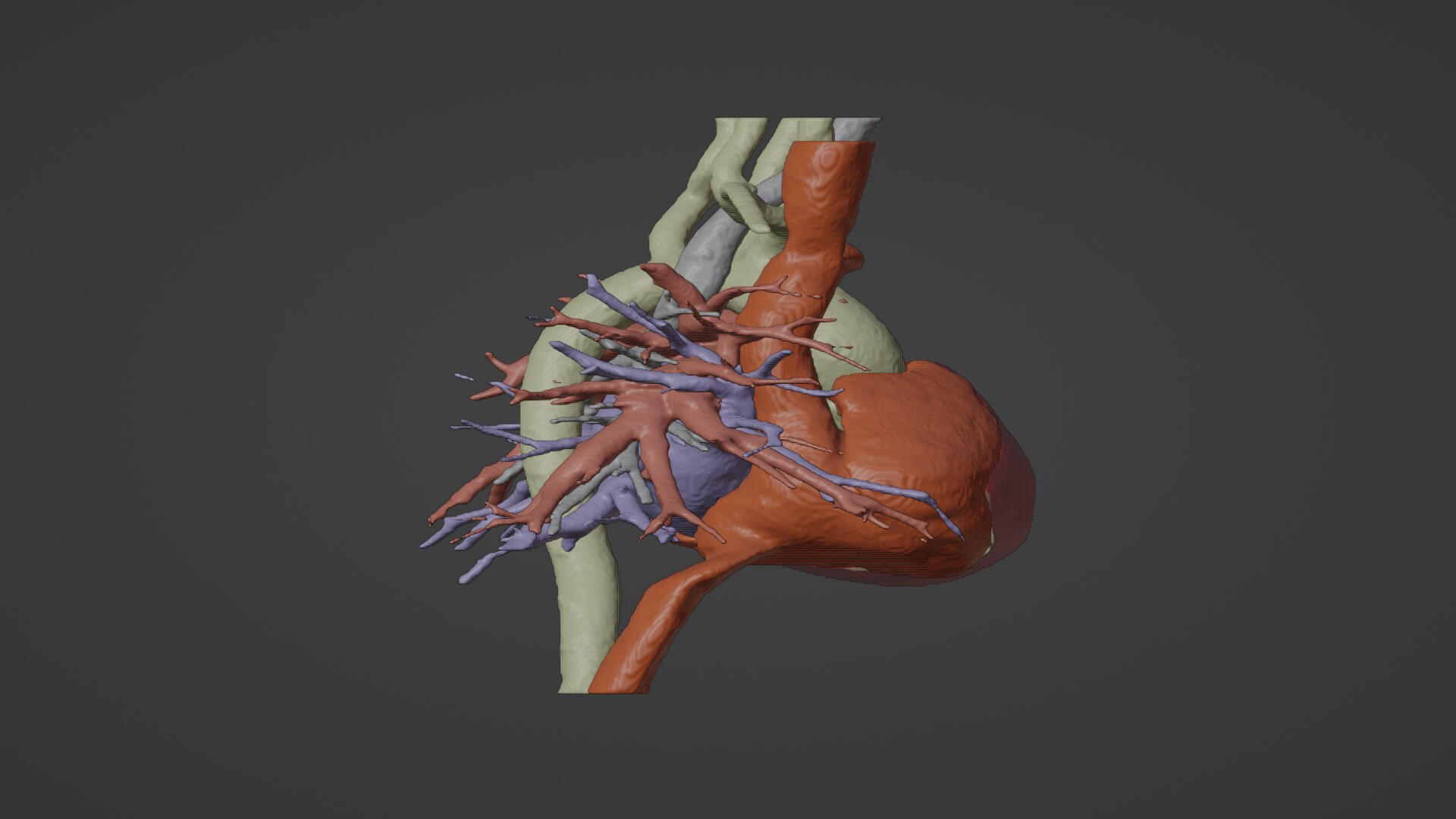 3D Model of Human Heart With Tetrology of Fallot (Tof) by azekapeka