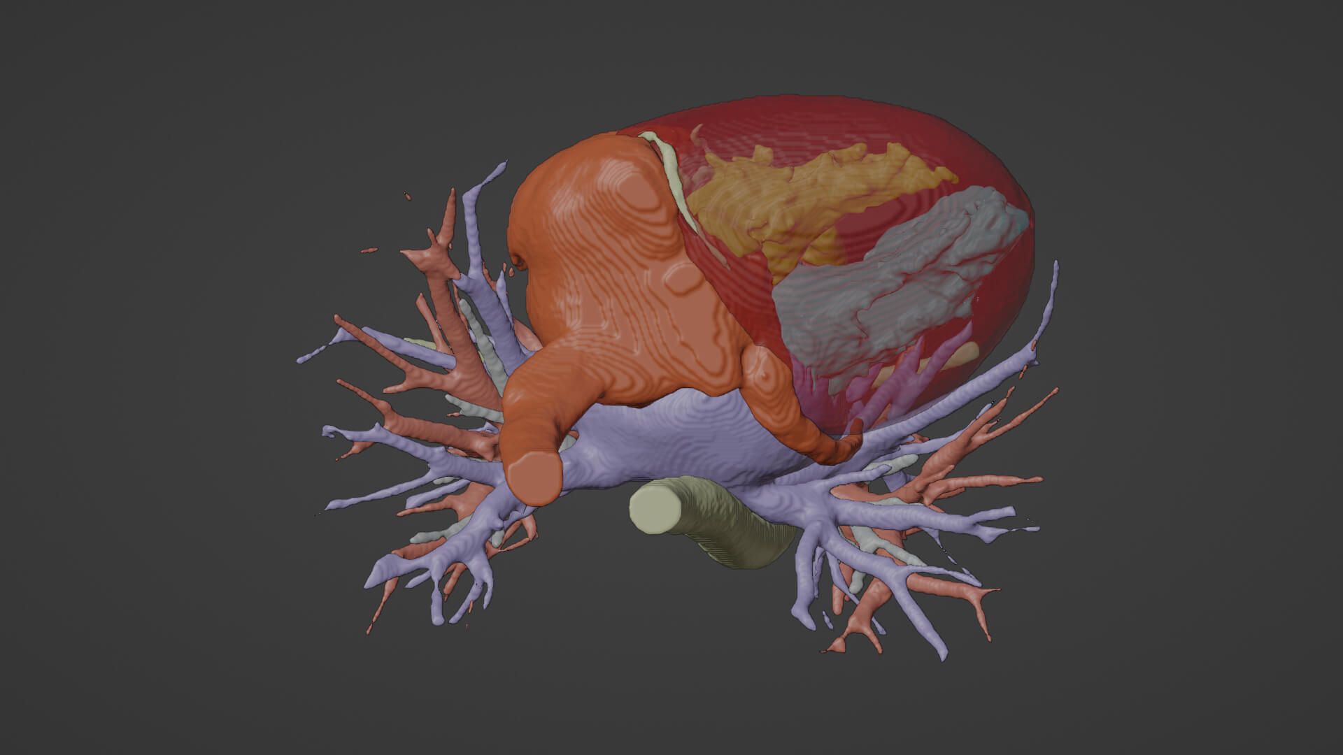 3D Model of Human Heart With Tetrology of Fallot (Tof) by azekapeka