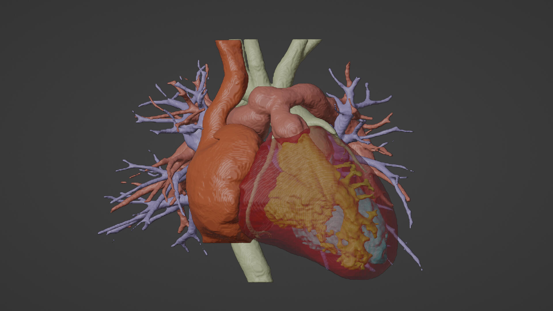 3D Model of Human Heart With Transposition of Great Arteries by azekapeka