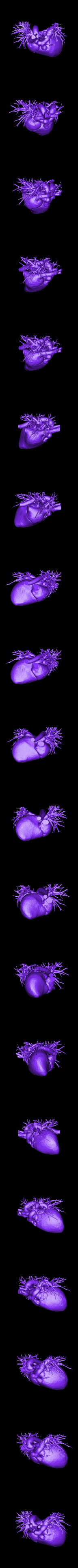 3D Model of Human Heart With Transposition of Great Arteries by azekapeka