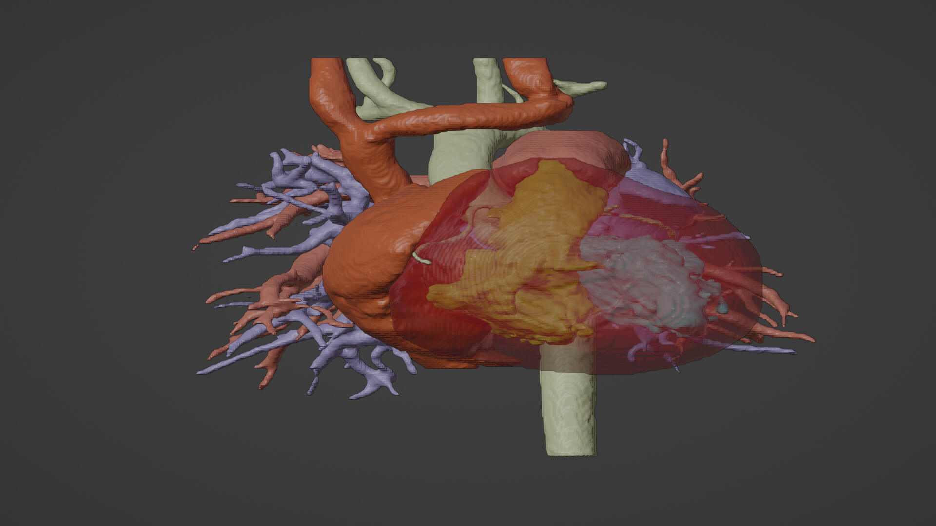 3D Model of Human Heart With Ventricular Septal Defect (Vsd) by azekapeka
