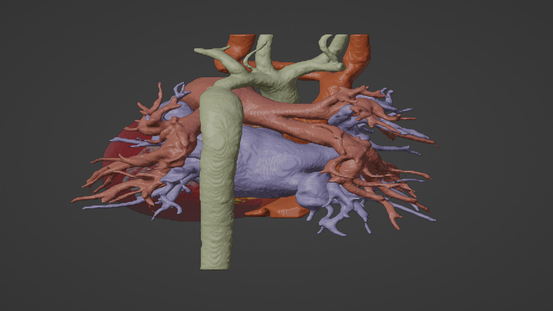 3D Model of Human Heart With Ventricular Septal Defect (Vsd) by azekapeka
