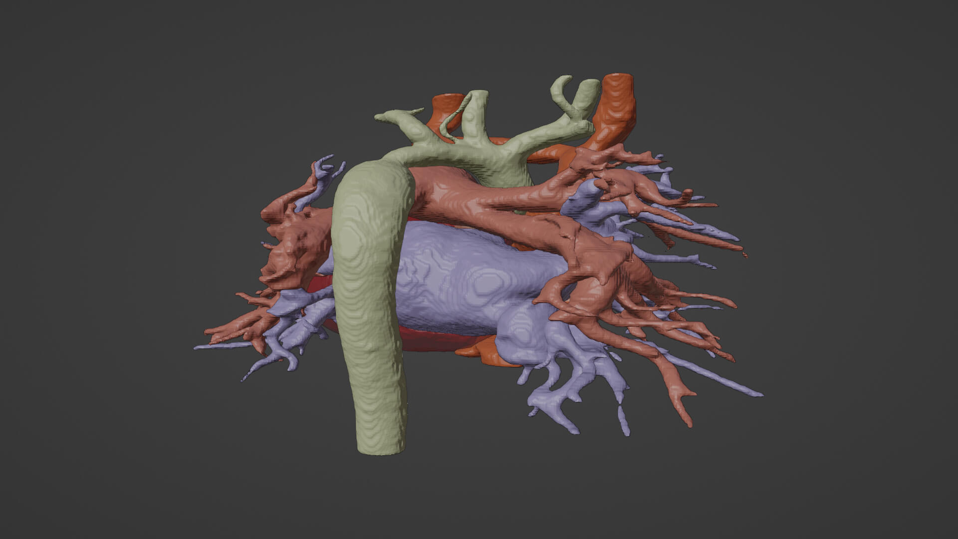 3D Model of Human Heart With Ventricular Septal Defect (Vsd) by azekapeka