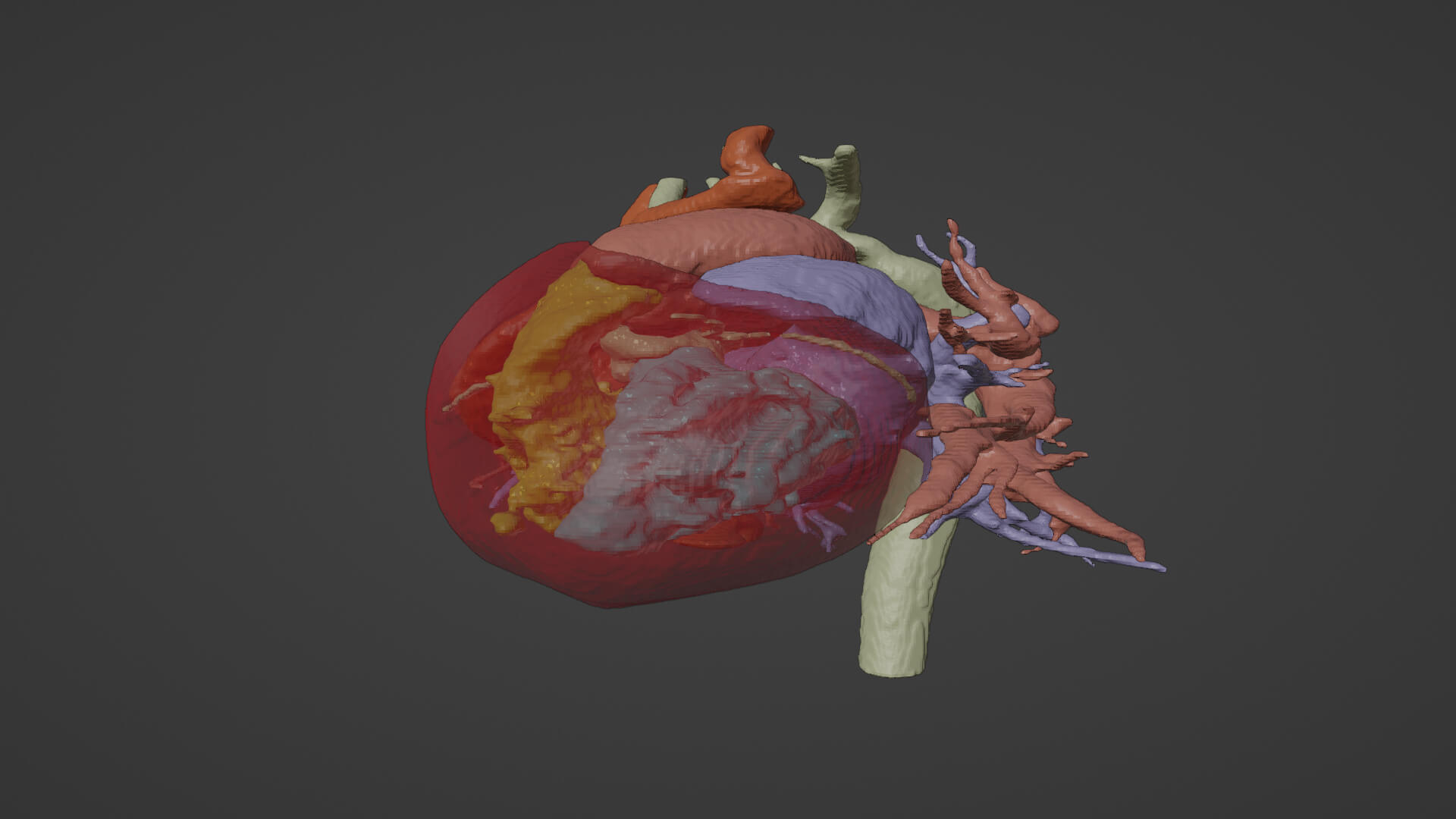 3D Model of Human Heart With Ventricular Septal Defect (Vsd) by azekapeka