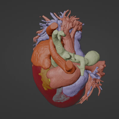 3D Model of Human Heart With Ventricular Septal Defect (Vsd) by azekapeka