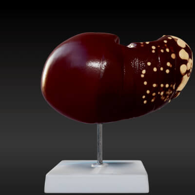 3D Model of Human Liver With The Progression of Liver Diseas by azekapeka