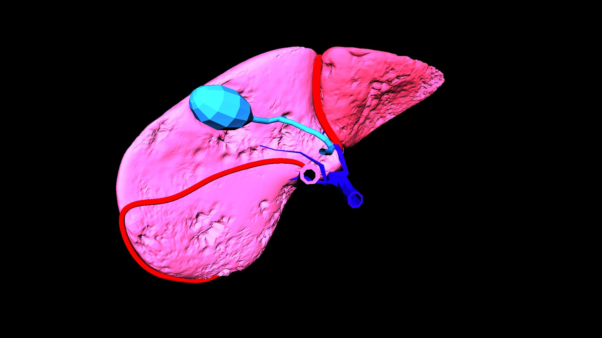3D Model of Liver With Fibrosis by azekapeka