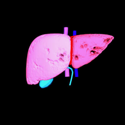 3D Model of Liver With Fibrosis by azekapeka