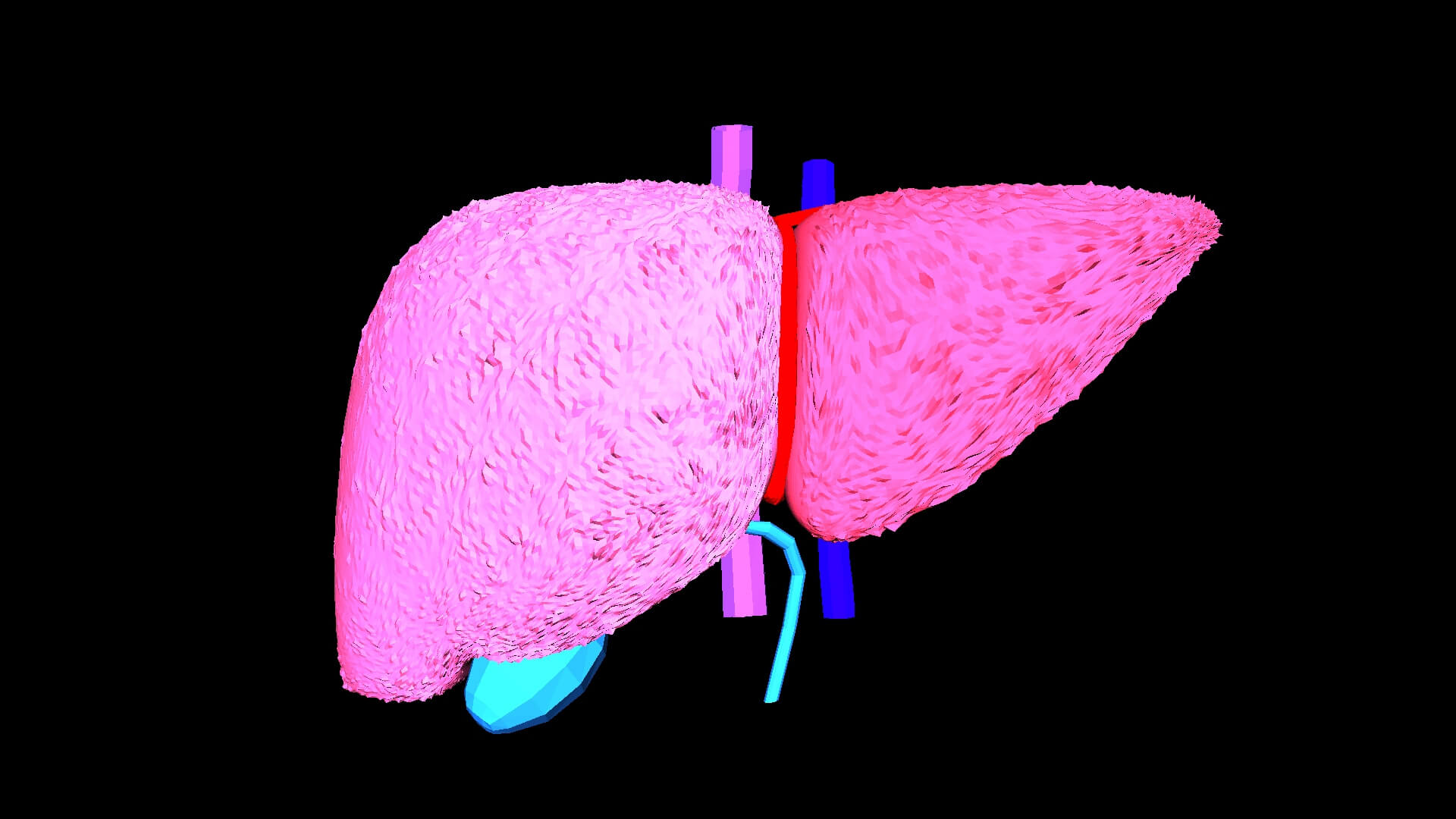 3D Model of Liver With Non-Alchocolic Steatohepatitis (Nash) by azekapeka