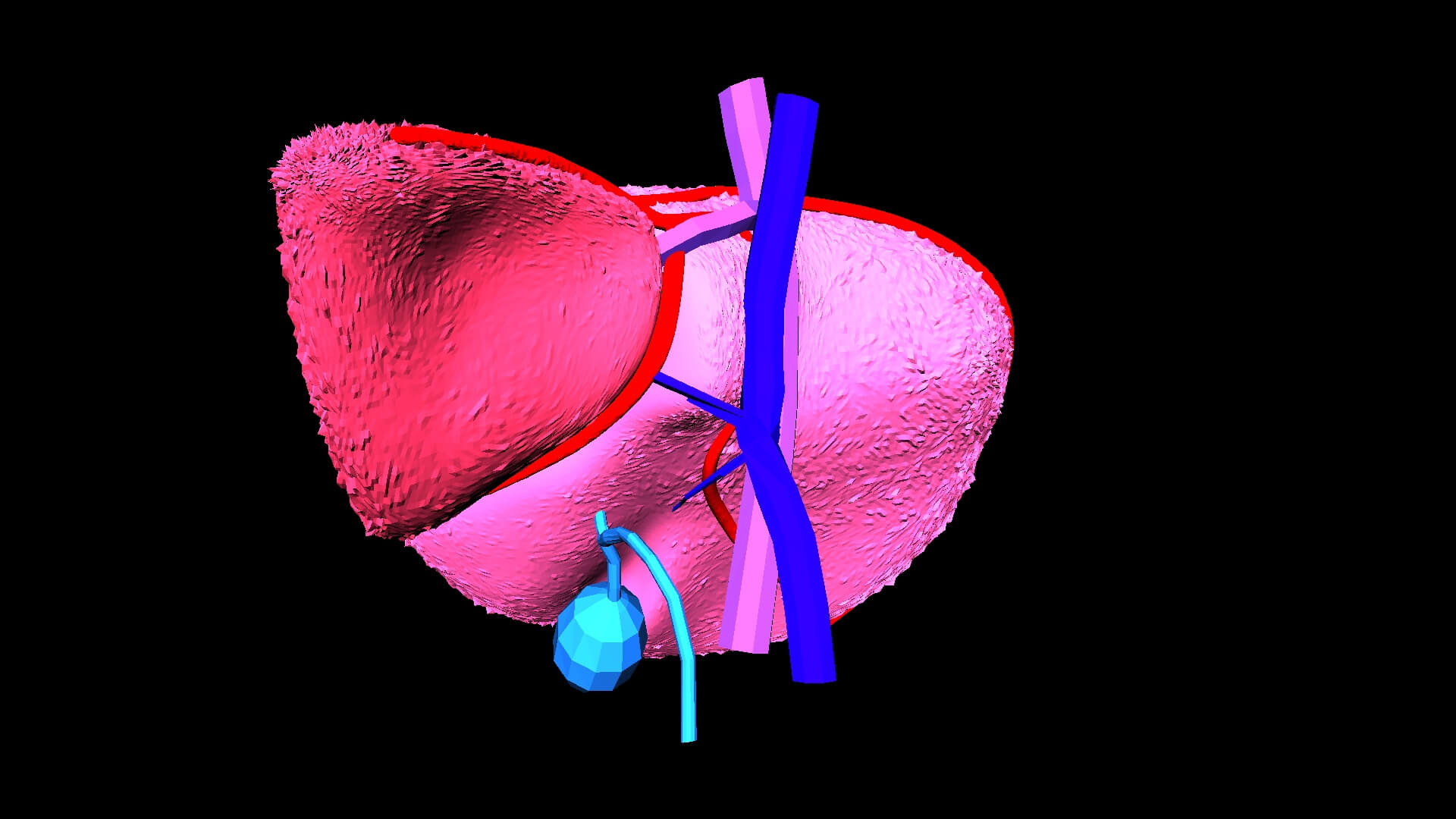 3D Model of Liver With Non-Alchocolic Steatohepatitis (Nash) by azekapeka