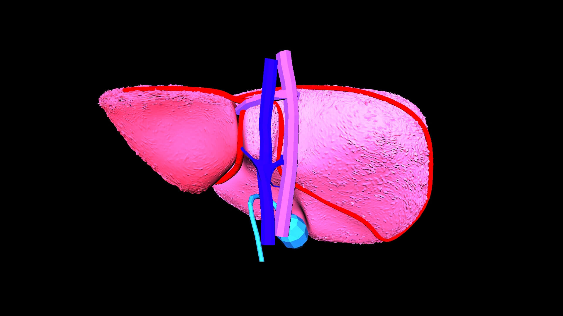 3D Model of Liver With Non-Alchocolic Steatohepatitis (Nash) by azekapeka