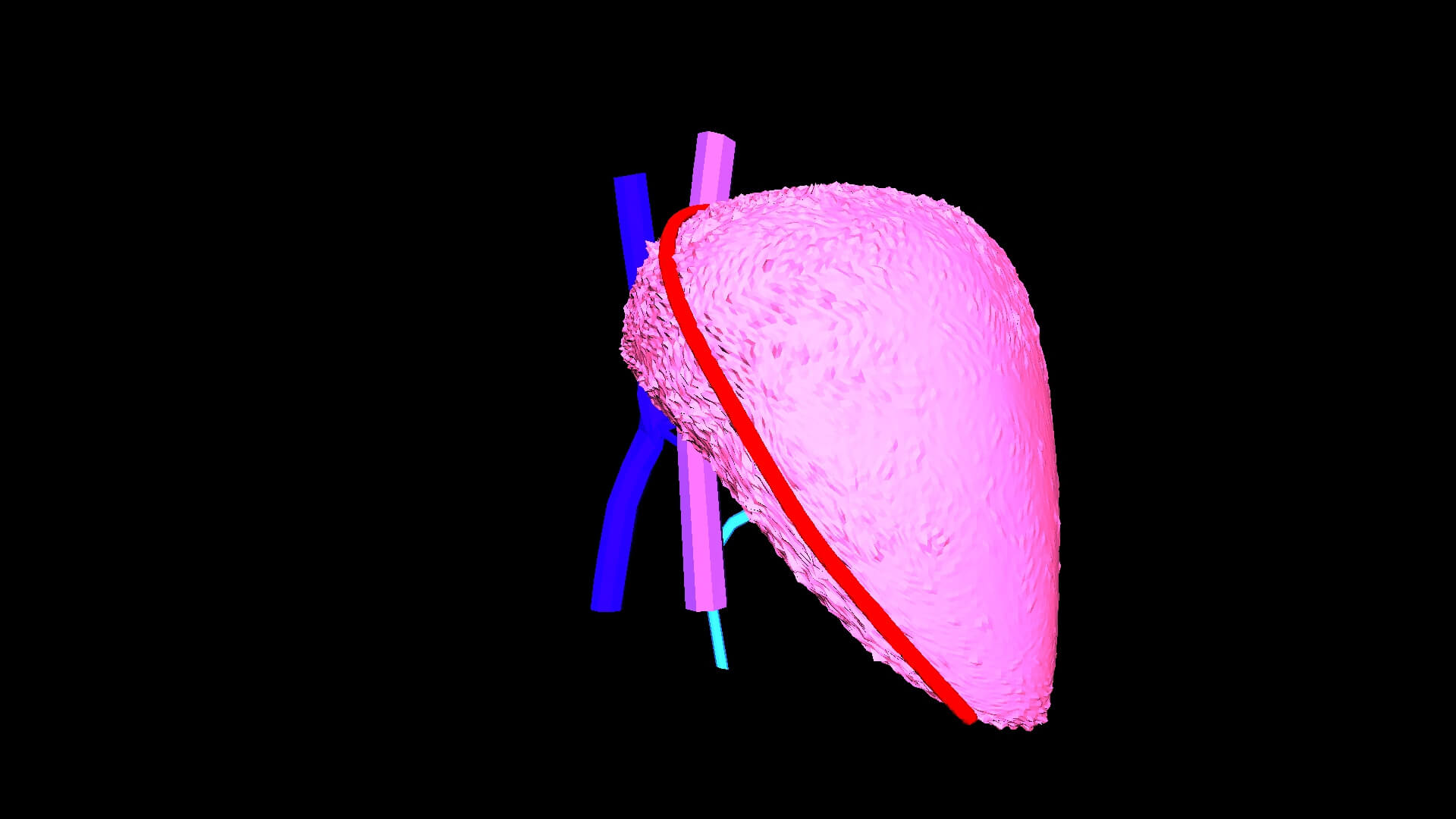 3D Model of Liver With Non-Alchocolic Steatohepatitis (Nash) by azekapeka