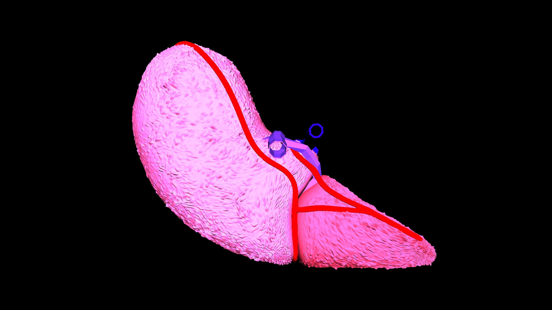3D Model of Liver With Non-Alchocolic Steatohepatitis (Nash) by azekapeka