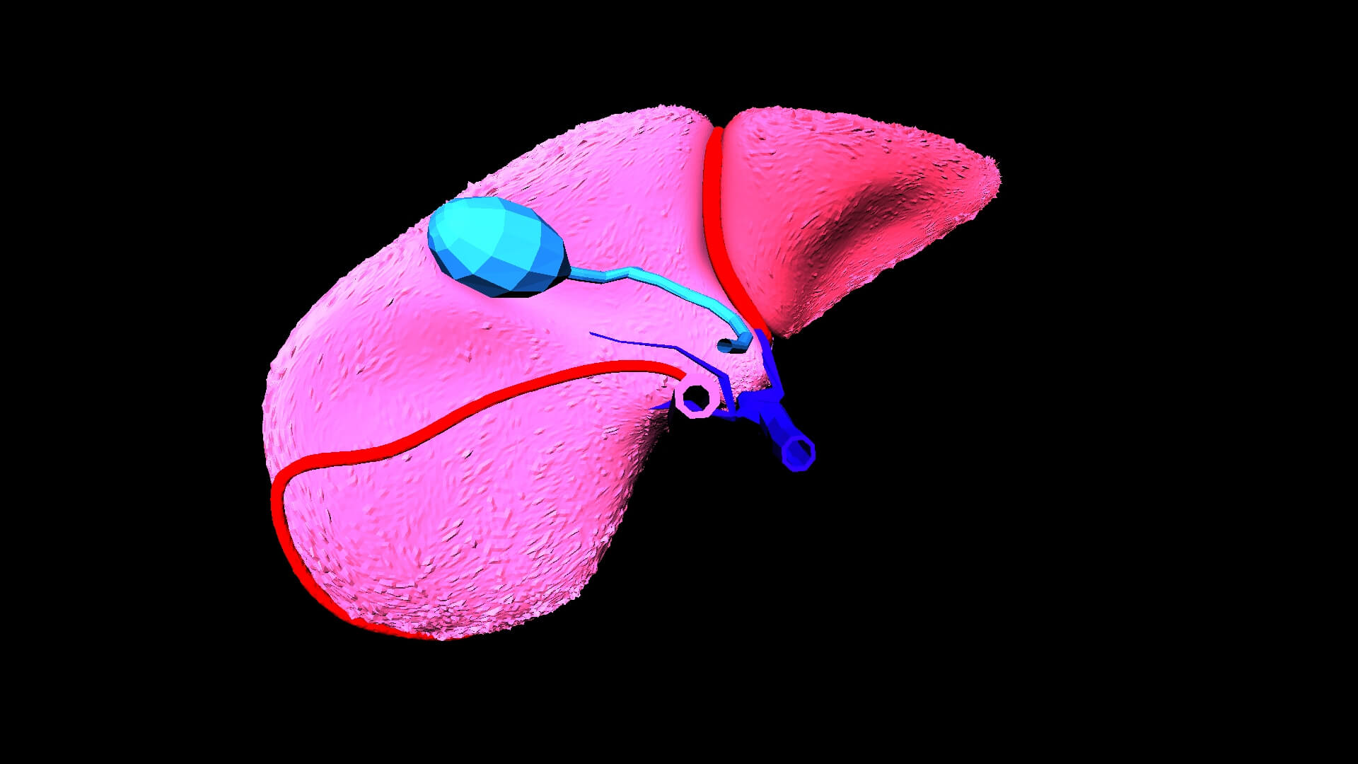 3D Model of Liver With Non-Alchocolic Steatohepatitis (Nash) by azekapeka