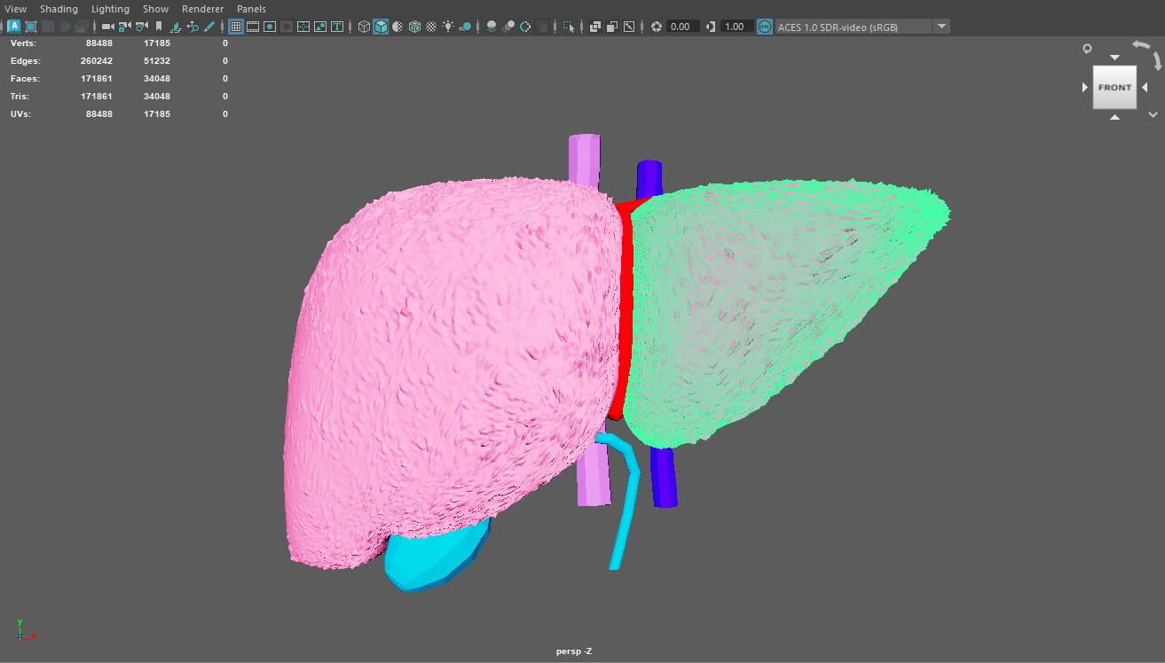 3D Model of Liver With Non-Alchocolic Steatohepatitis (Nash) by azekapeka